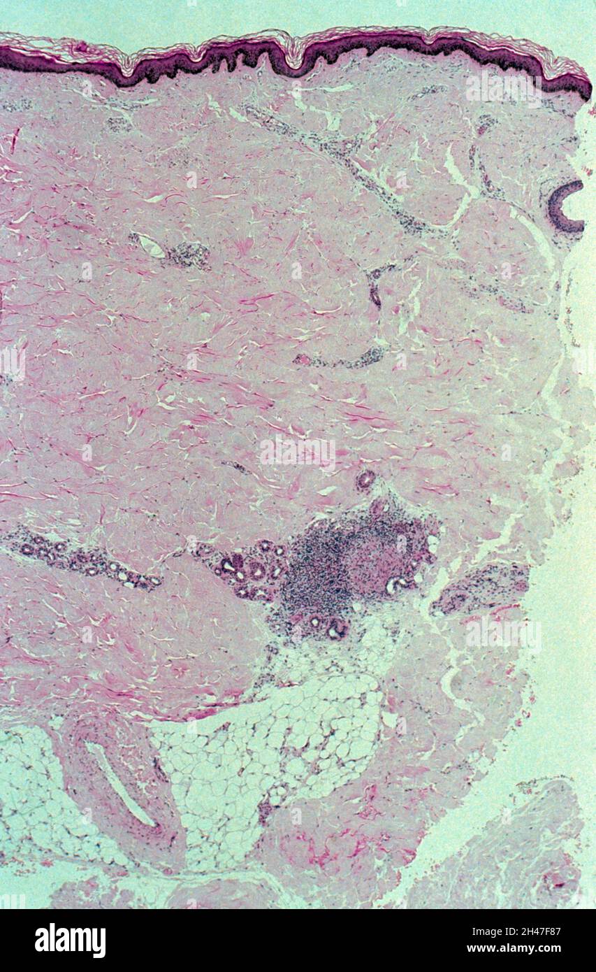 Leprosy: borderline tuberculoid leprosy, skin Stock Photo - Alamy