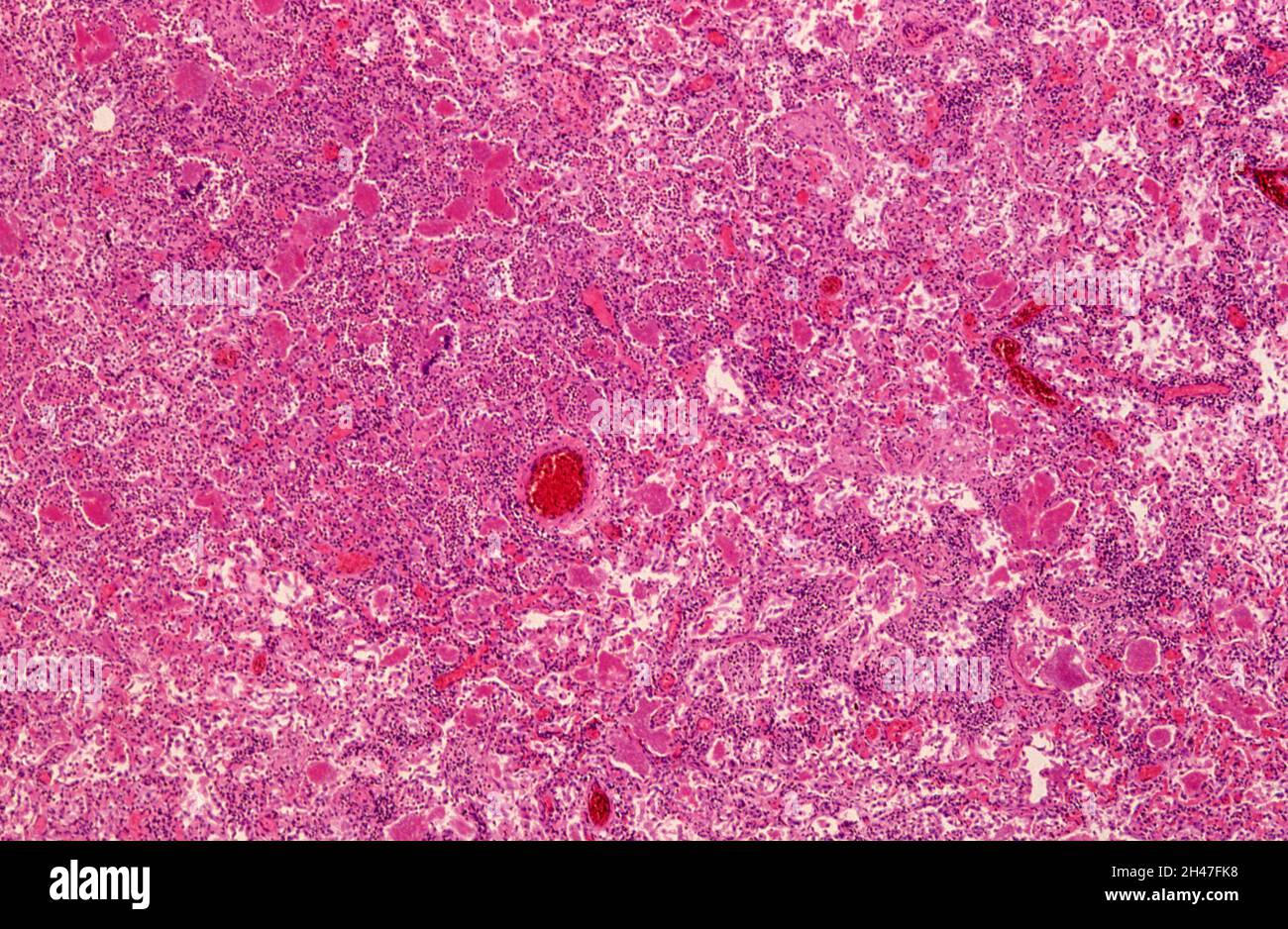 Lung: Pneumocystis carinii pneumonia (PCP) with HIV Stock Photo - Alamy