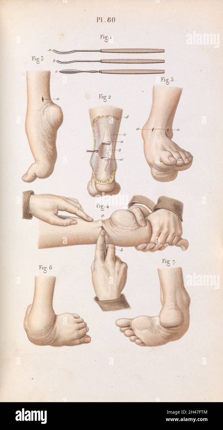 Plate 80, Surgical technique to repair club foot Stock Photo - Alamy