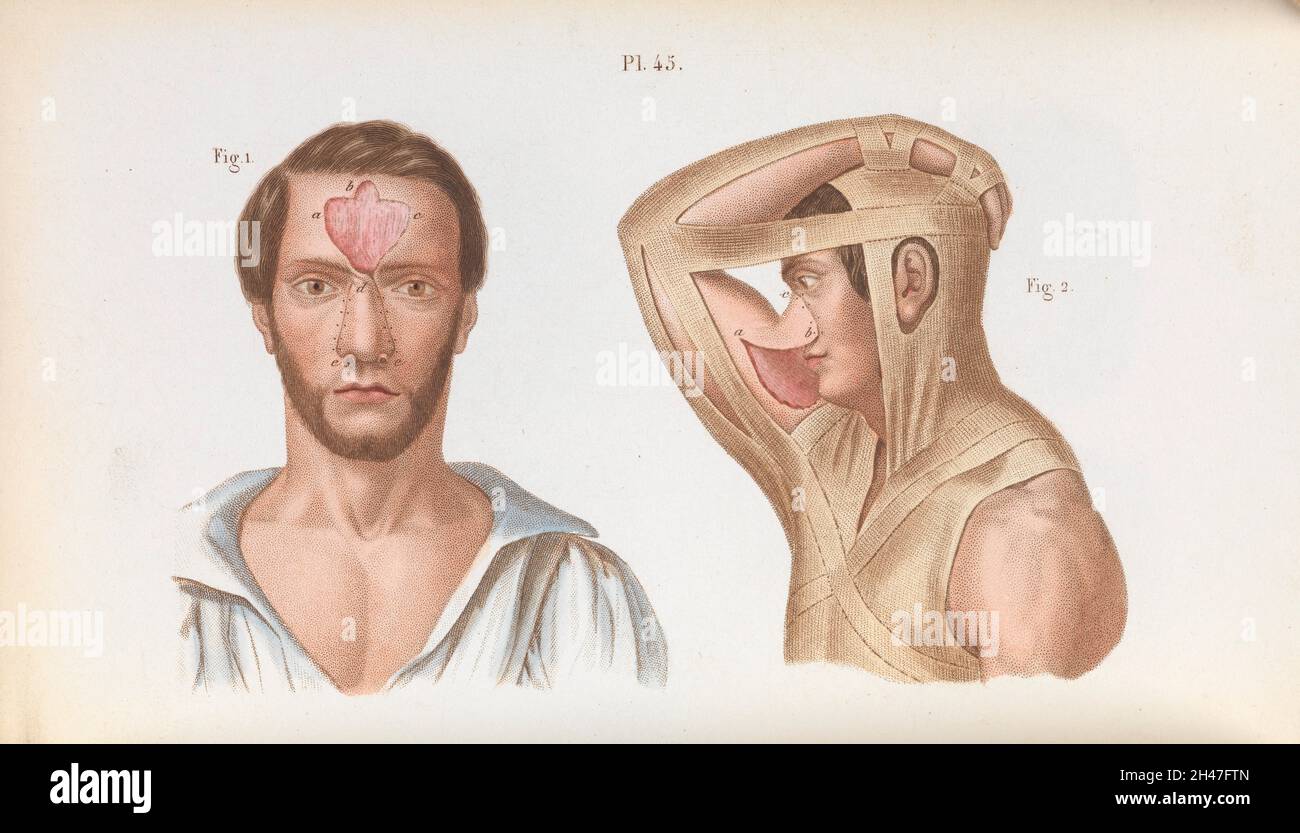 Plate 45, Plastic surgery of the nose Stock Photo - Alamy