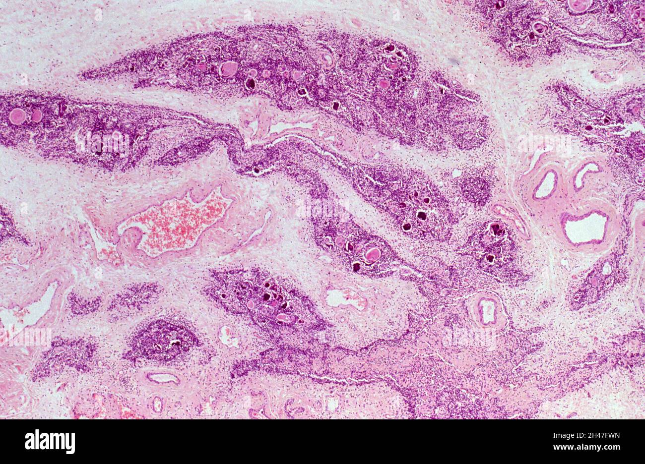 Atrophy of the thymus in AIDS Stock Photo - Alamy