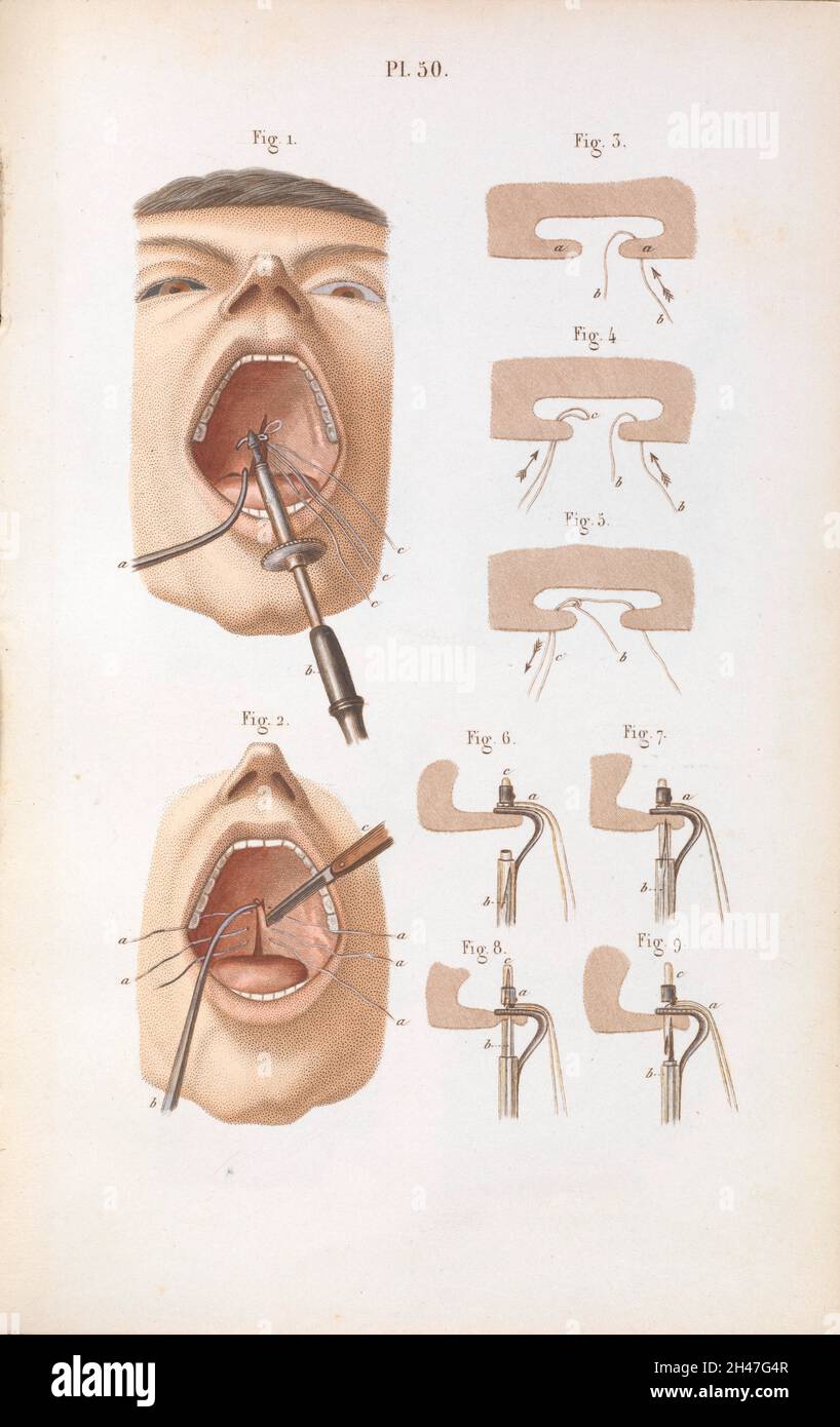Plate 50, Surgical technique for cleft palate Stock Photo - Alamy