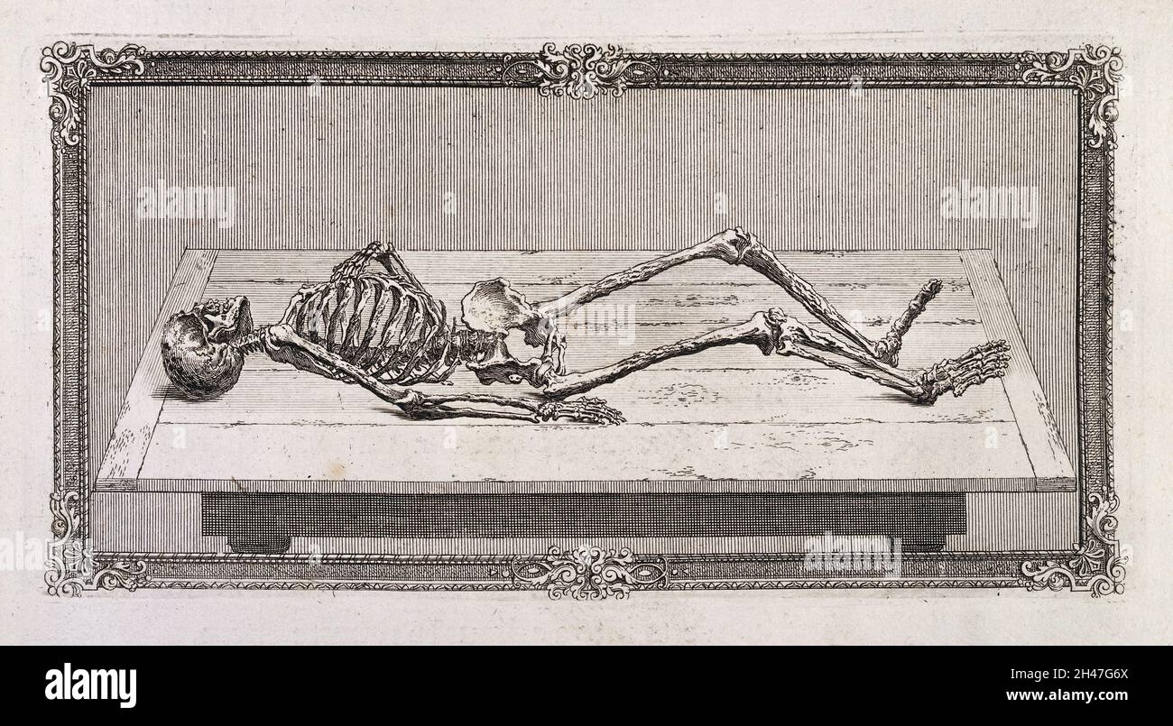 A skeleton showing the diseased bones of the body Stock Photo - Alamy