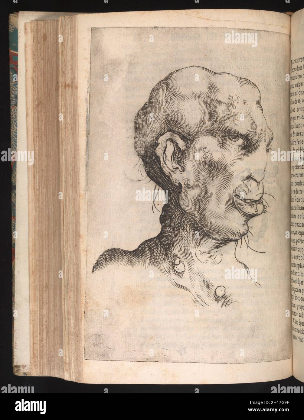 Head illustrating syptoms of syphilis. Engraving, 1632 Stock Photo - Alamy