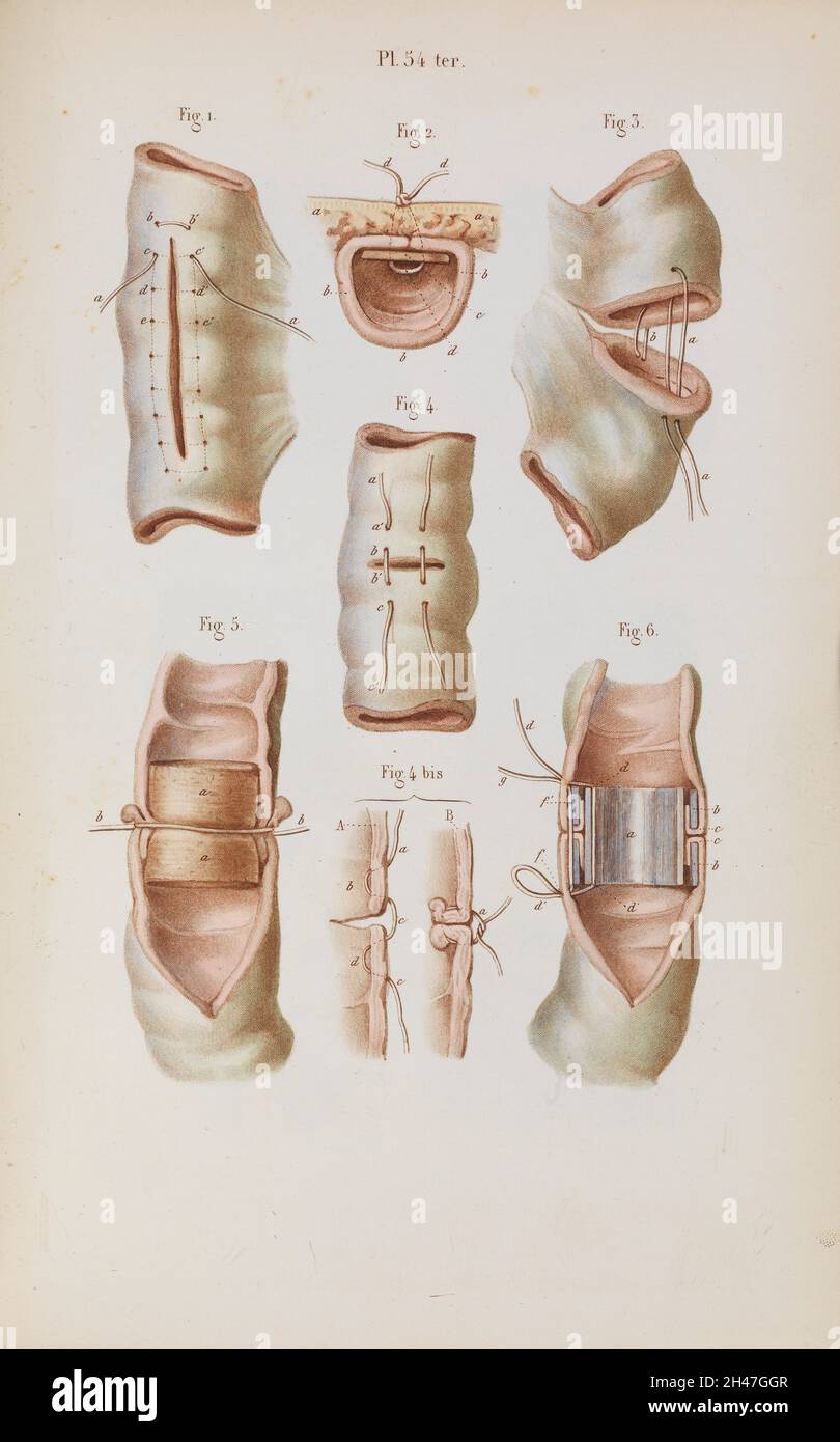 Suturing hi-res stock photography and images - Alamy
