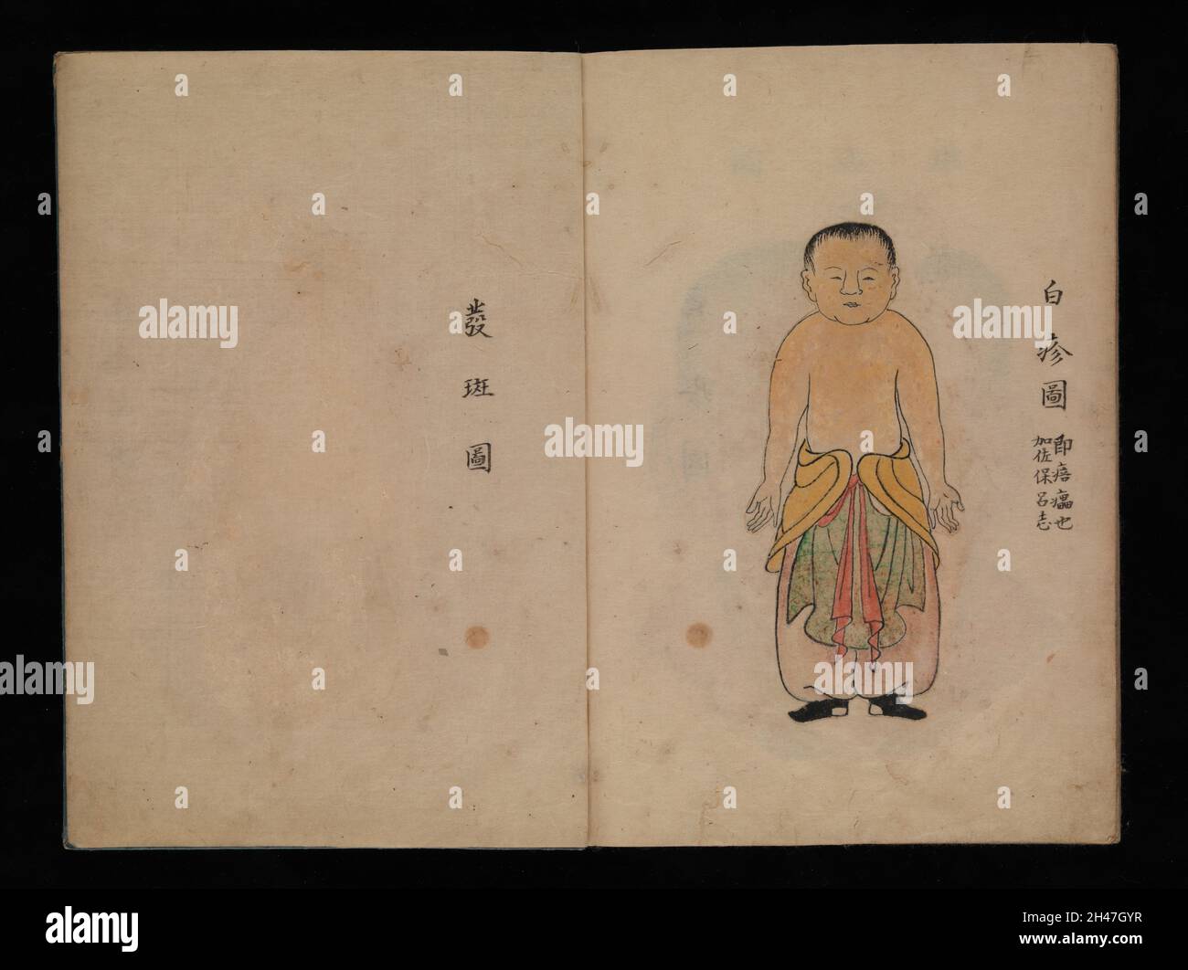 Smallpox illustration, Japanese manuscript, c. 1720 Stock Photo - Alamy