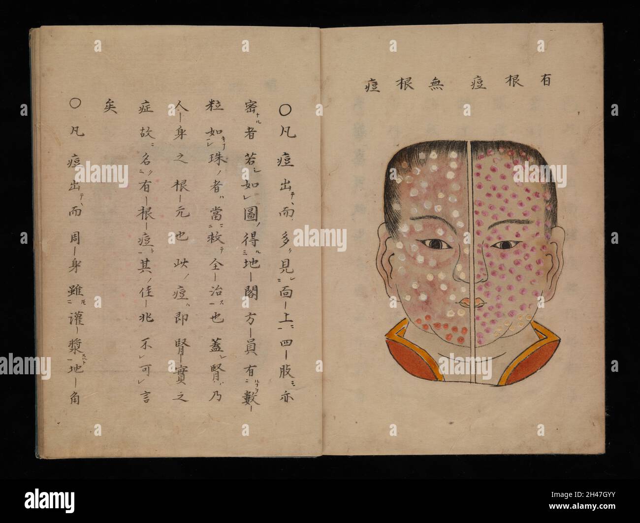 Smallpox lesions hi-res stock photography and images - Alamy