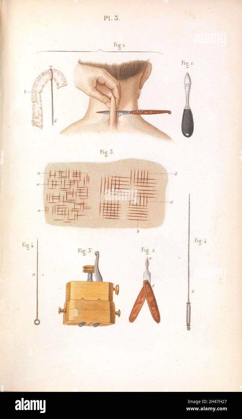 Seton stitch hi-res stock photography and images - Alamy