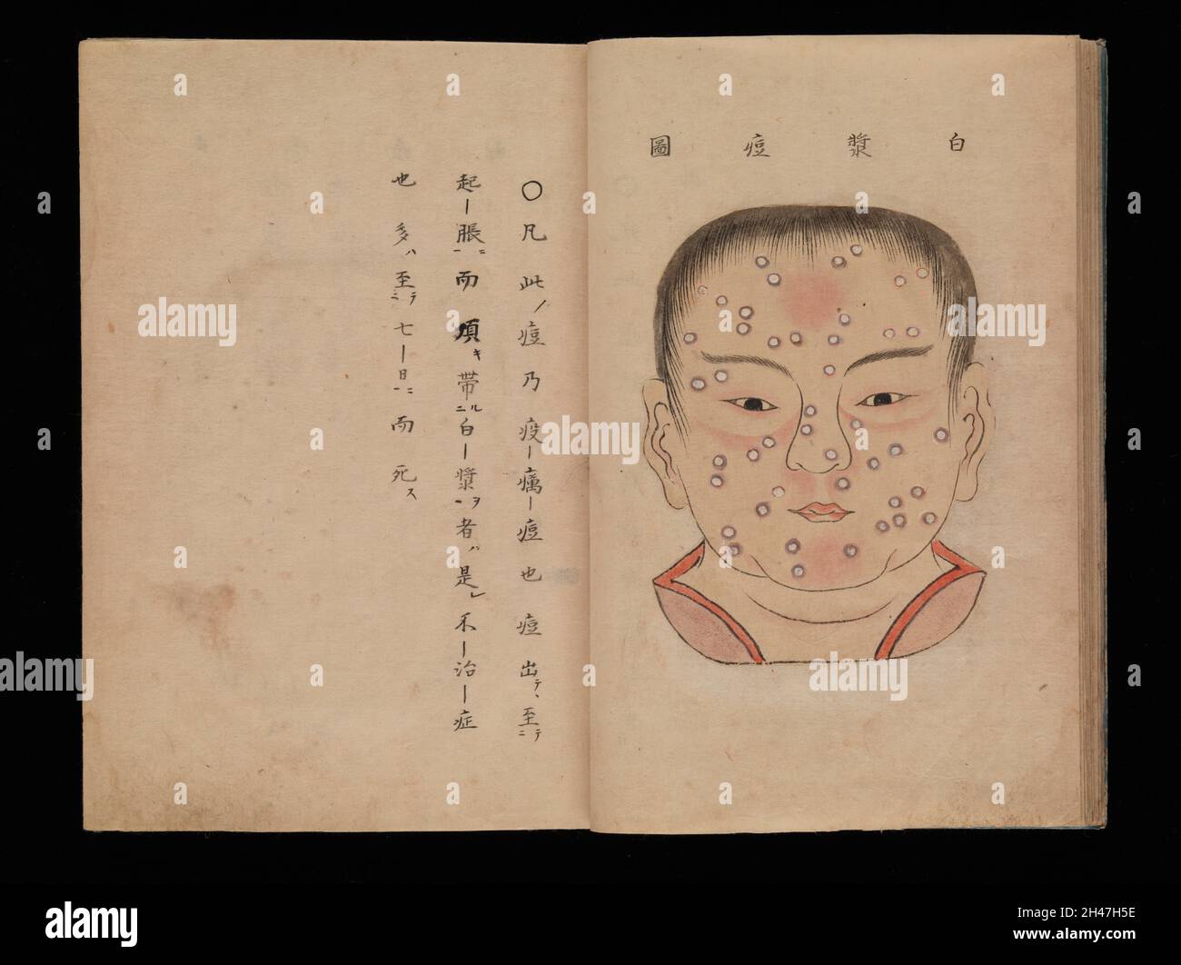 Smallpox illustration, Japanese manuscript, c. 1720 Stock Photo - Alamy