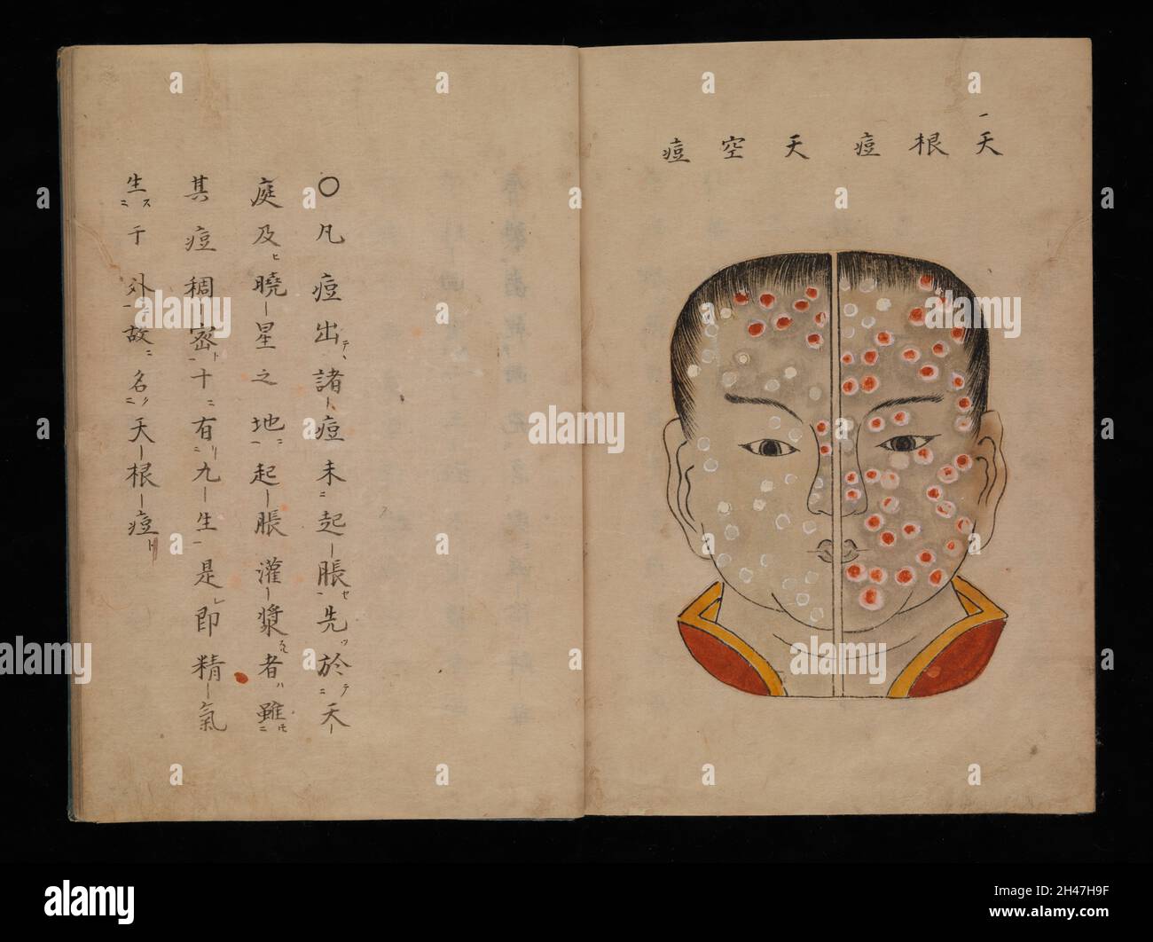 Smallpox illustration, Japanese manuscript, c. 1720 Stock Photo - Alamy