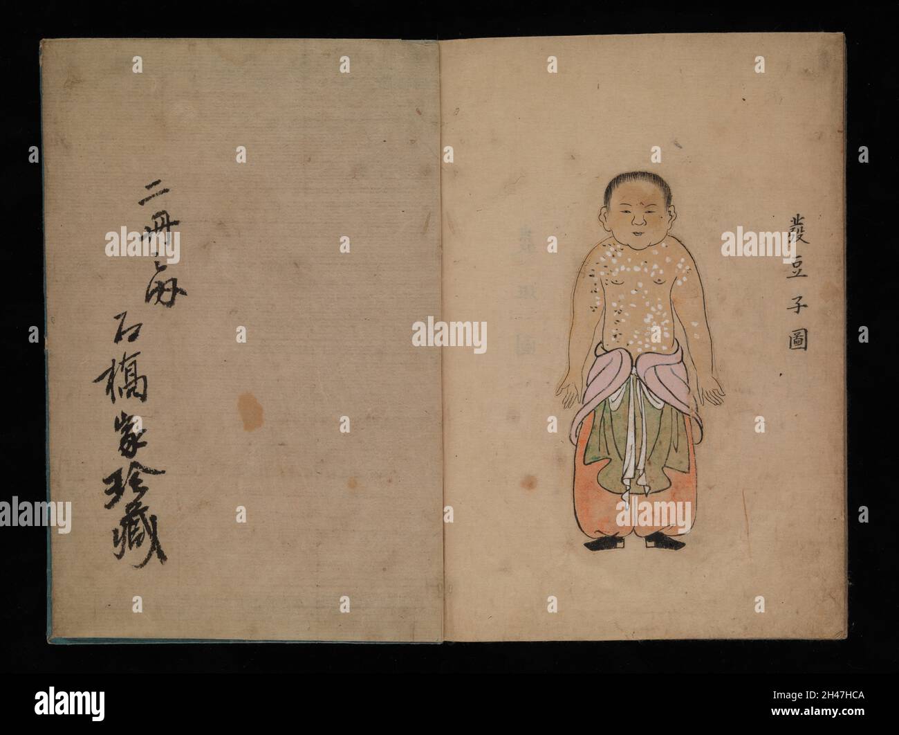 Smallpox illustration, Japanese manuscript, c. 1720 Stock Photo - Alamy