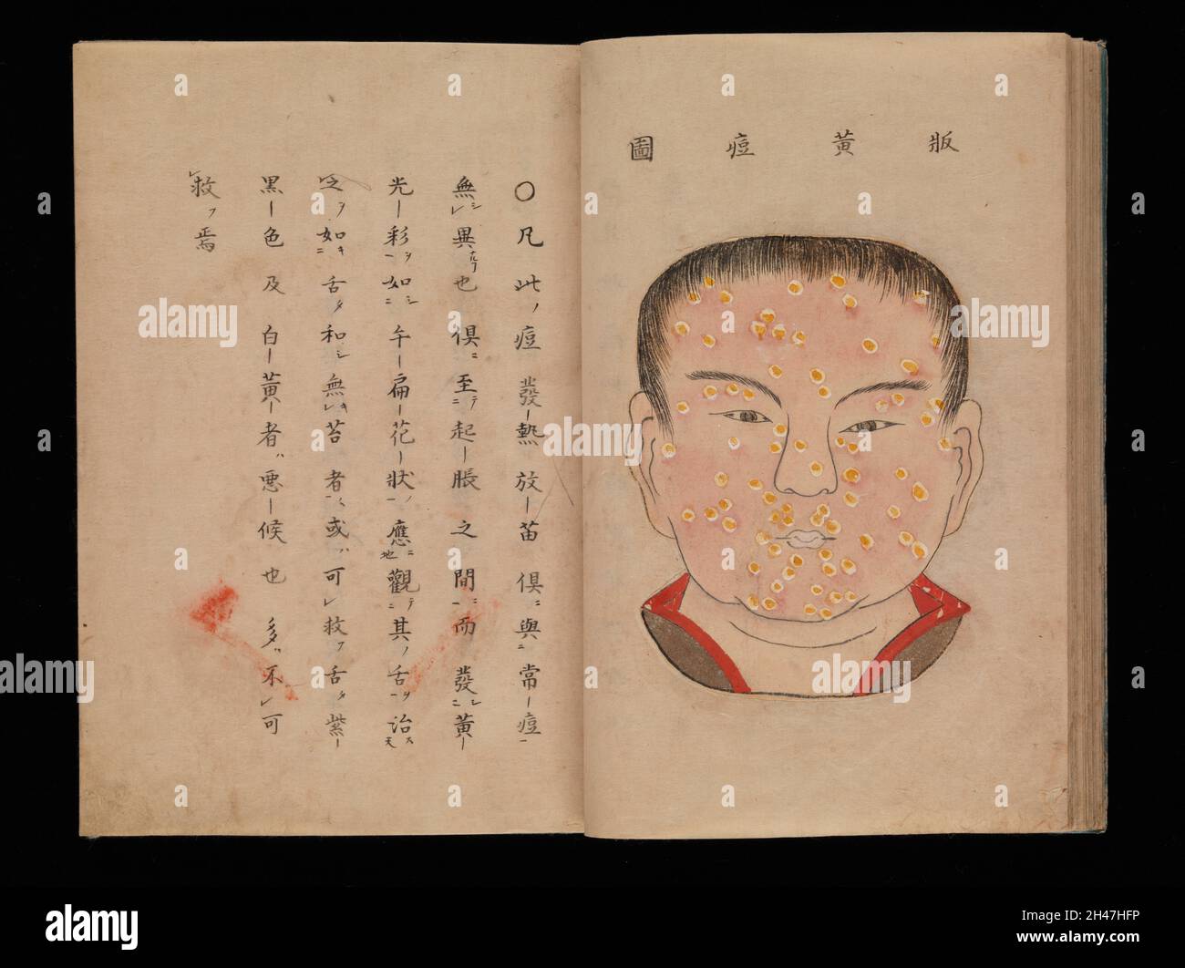 Smallpox illustration, Japanese manuscript, c. 1720 Stock Photo - Alamy