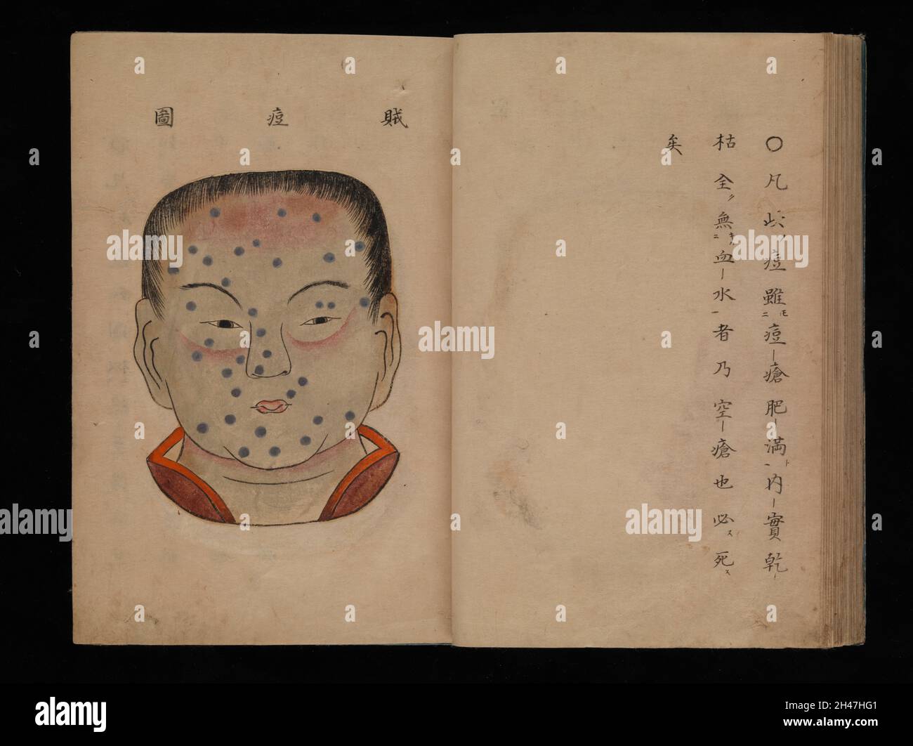 Smallpox illustration, Japanese manuscript, c. 1720 Stock Photo - Alamy