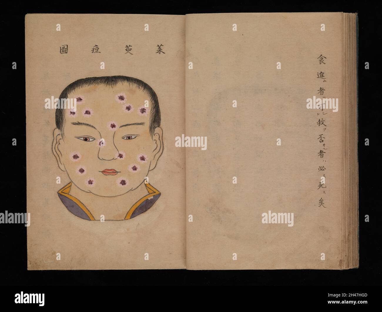 Smallpox skin lesions hi-res stock photography and images - Alamy