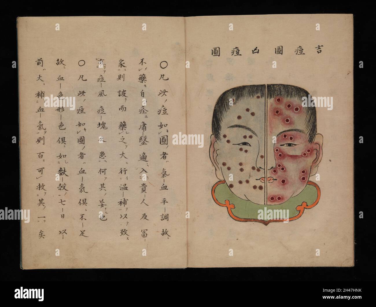 Smallpox illustration, Japanese manuscript, c. 1720 Stock Photo - Alamy