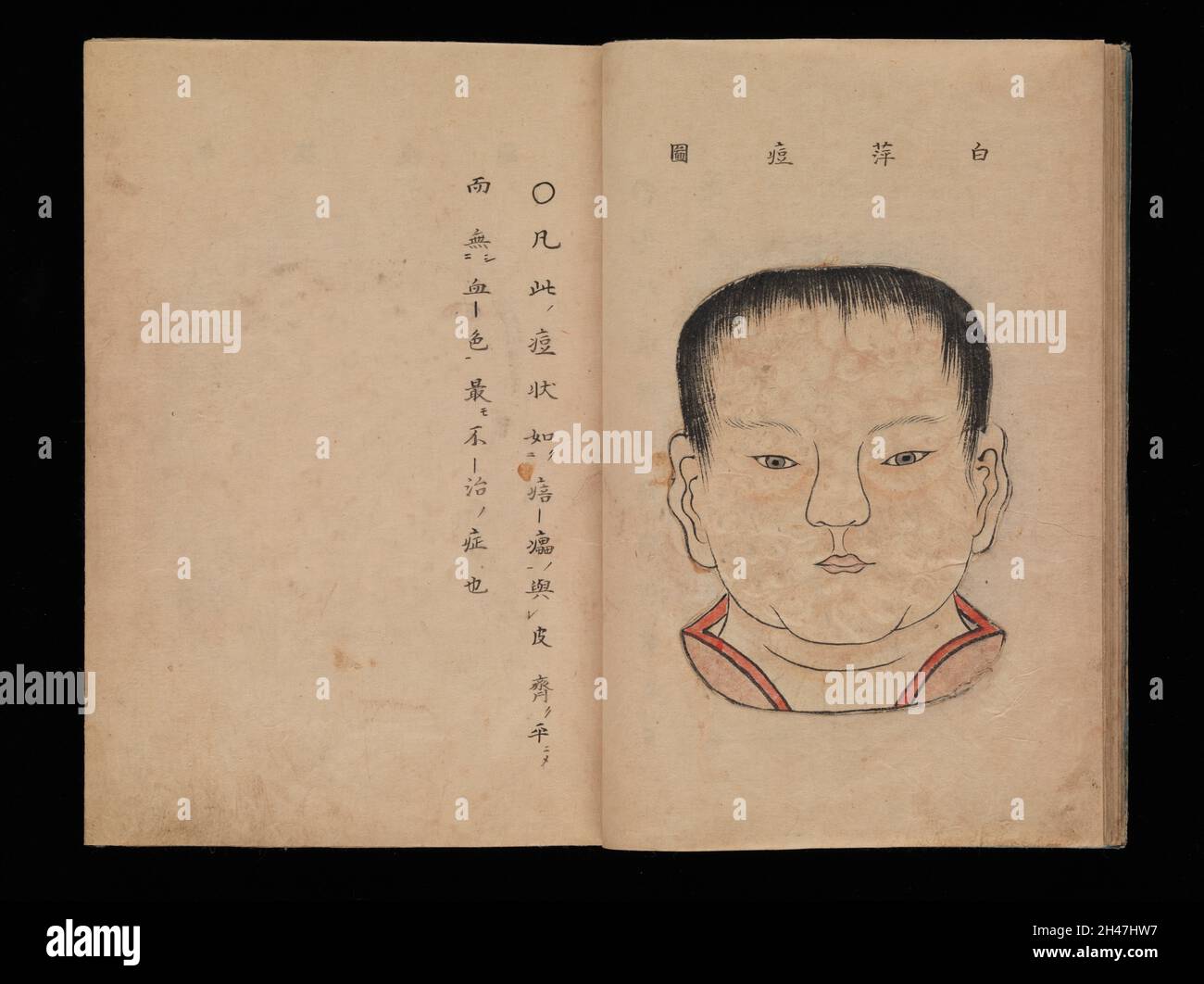 Smallpox illustration, Japanese manuscript, c. 1720 Stock Photo - Alamy