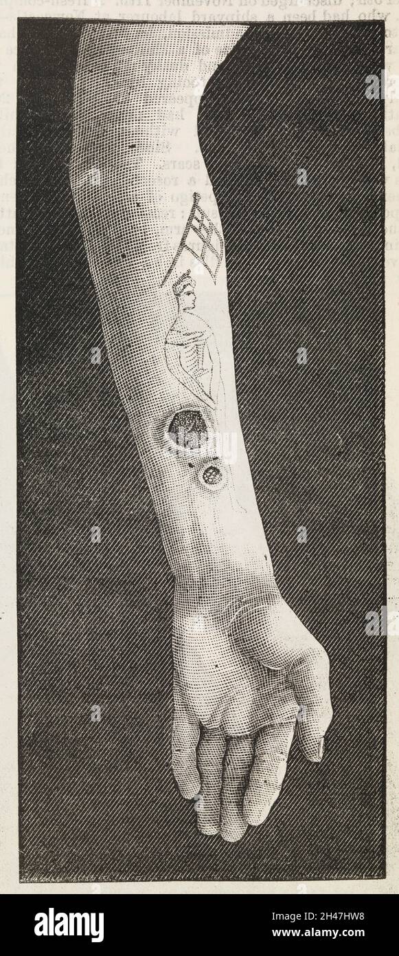 Signs of syphilis on the site of a tattoo Stock Photo - Alamy