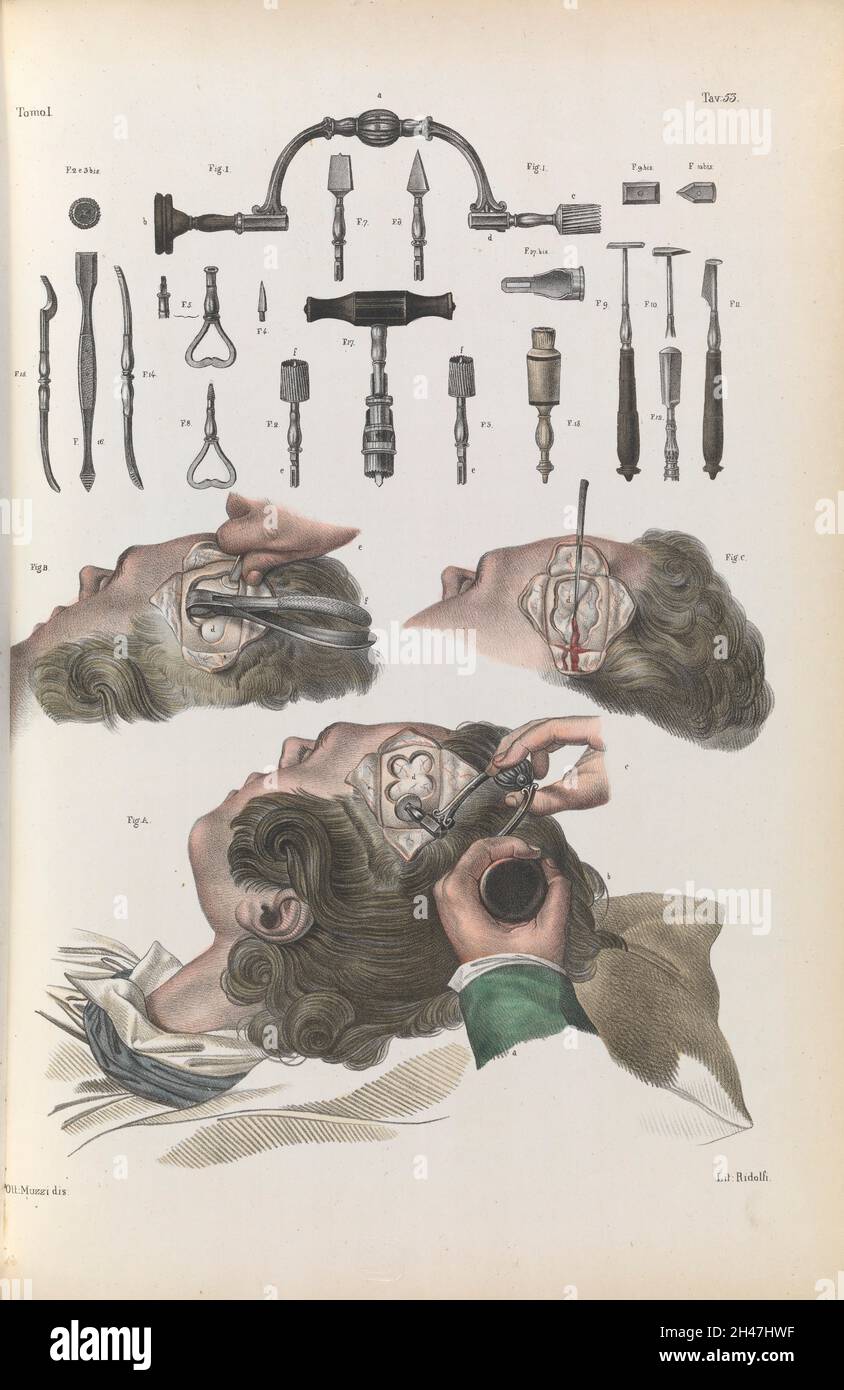 Plate 53. Surgical technique and instruments for trepanation Stock ...