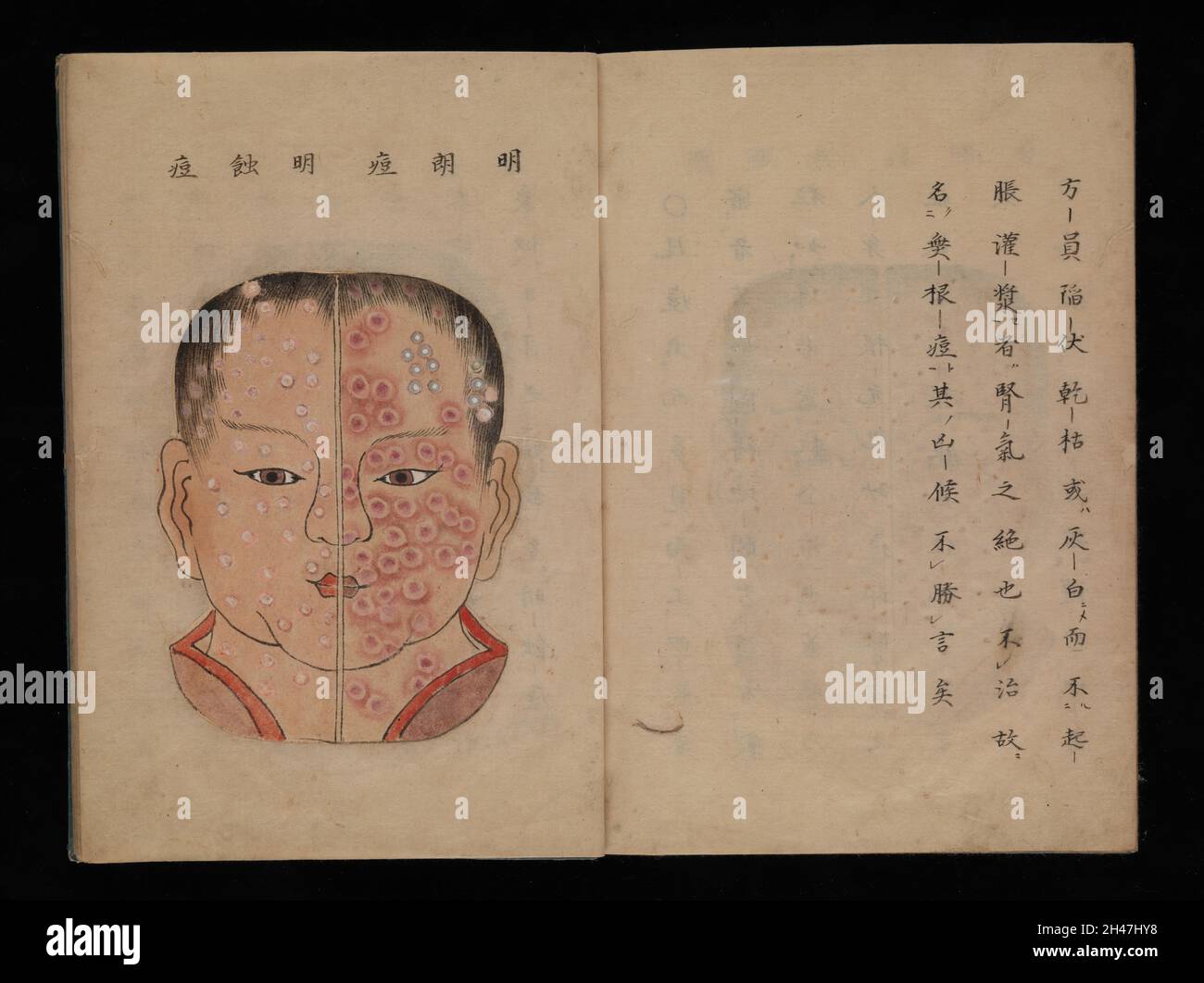 Smallpox lesions hi-res stock photography and images - Alamy