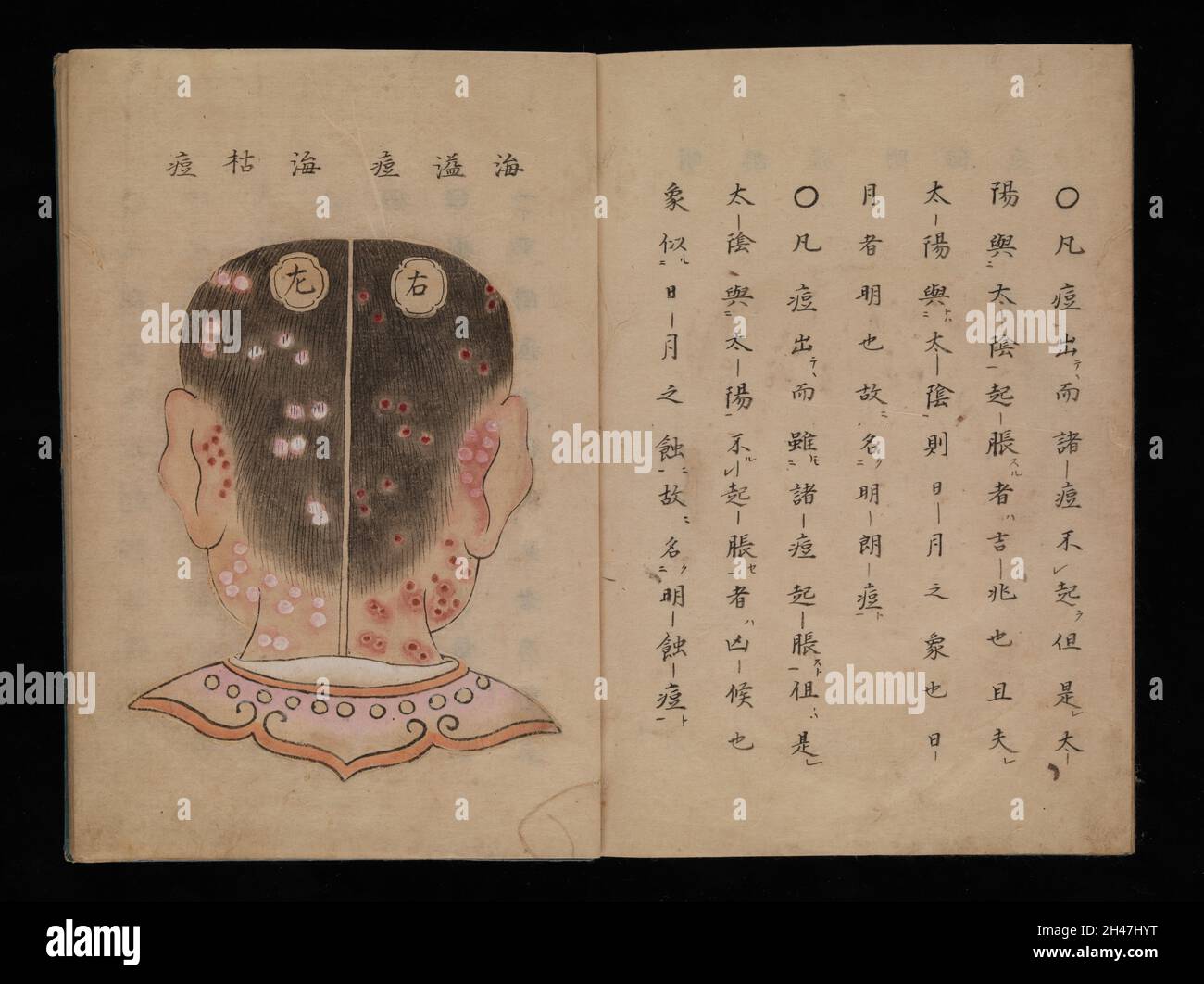 Smallpox illustration, Japanese manuscript, c. 1720 Stock Photo - Alamy