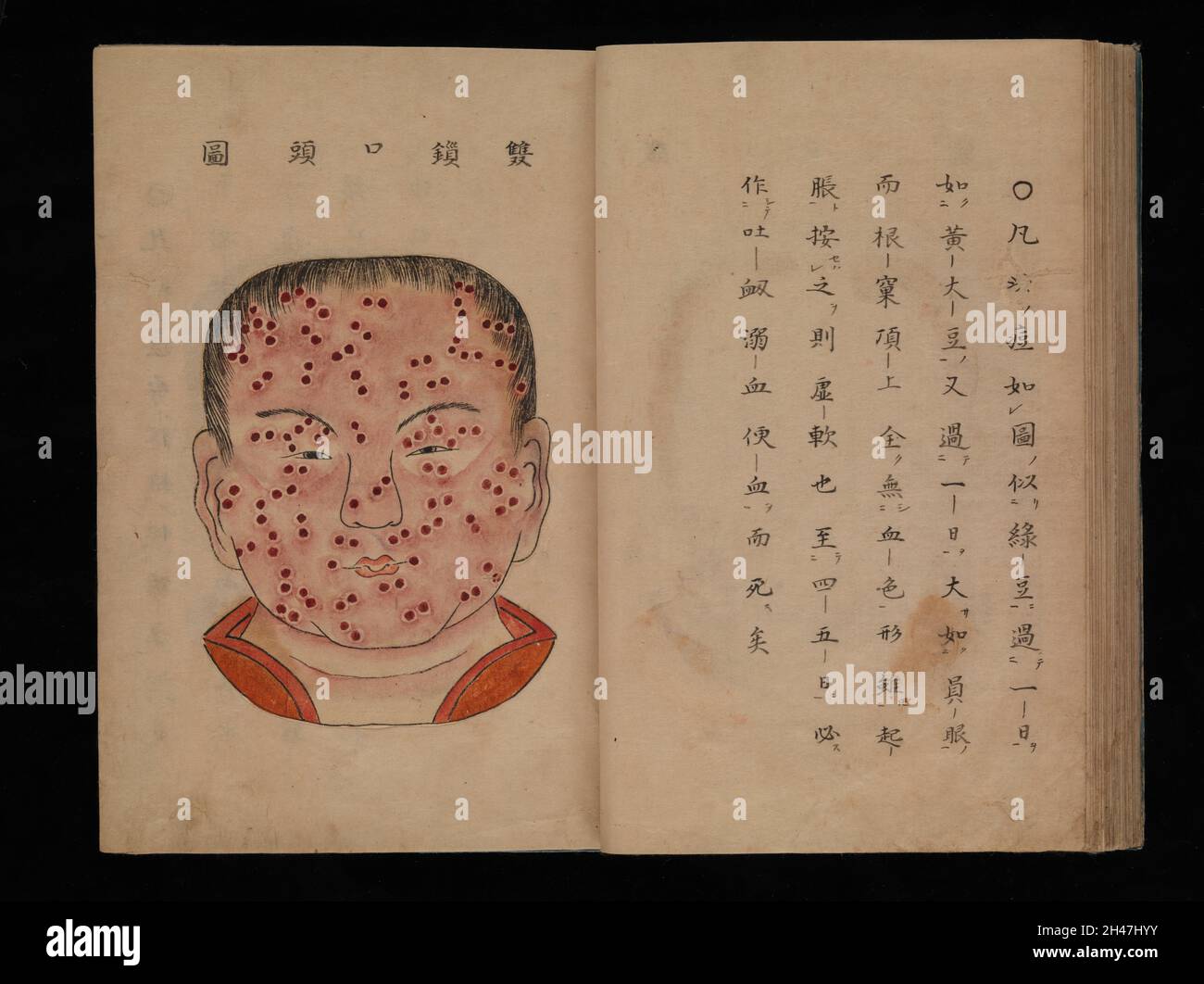 Smallpox illustration, Japanese manuscript, c. 1720 Stock Photo - Alamy
