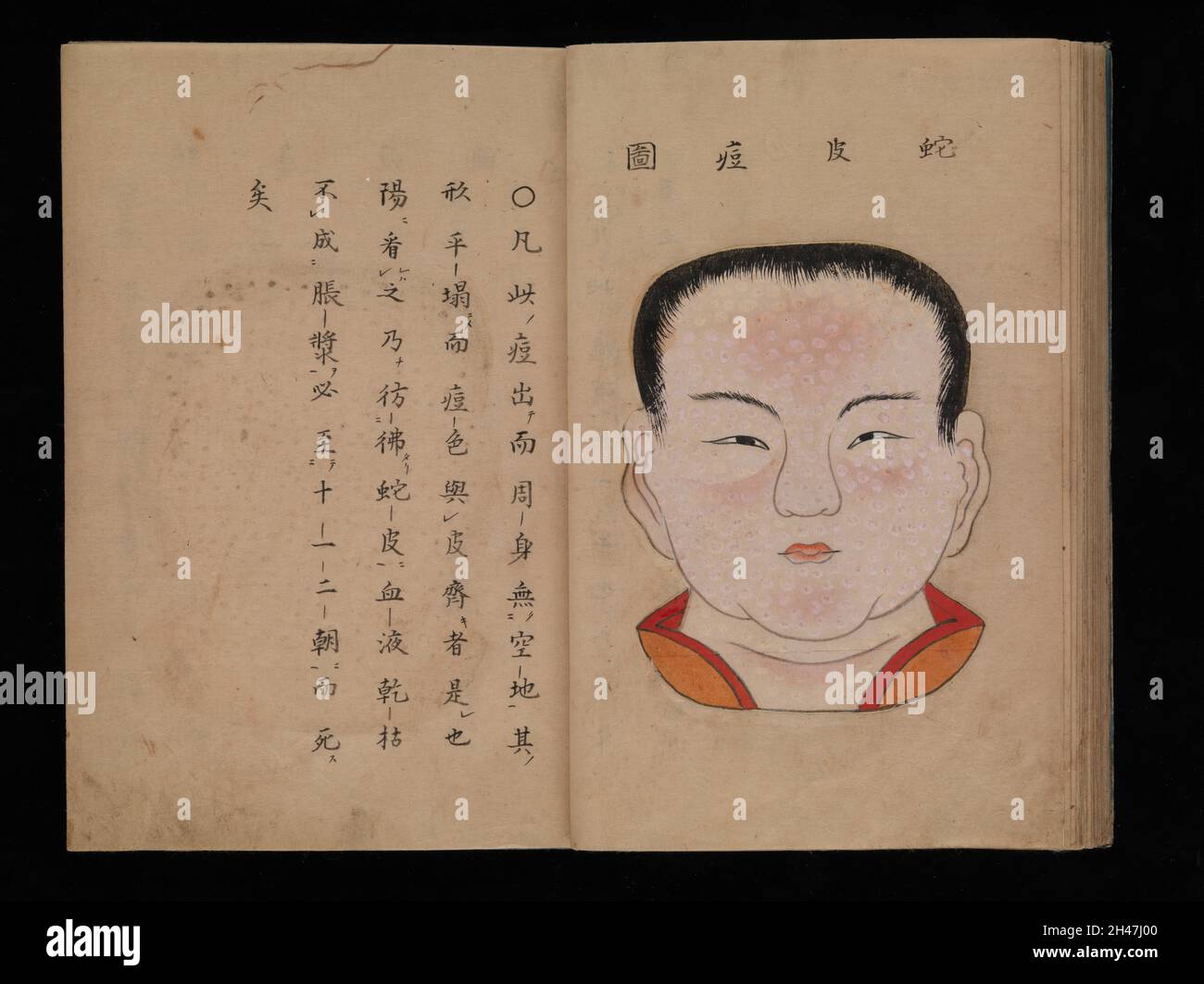 Smallpox illustration, Japanese manuscript, c. 1720 Stock Photo - Alamy