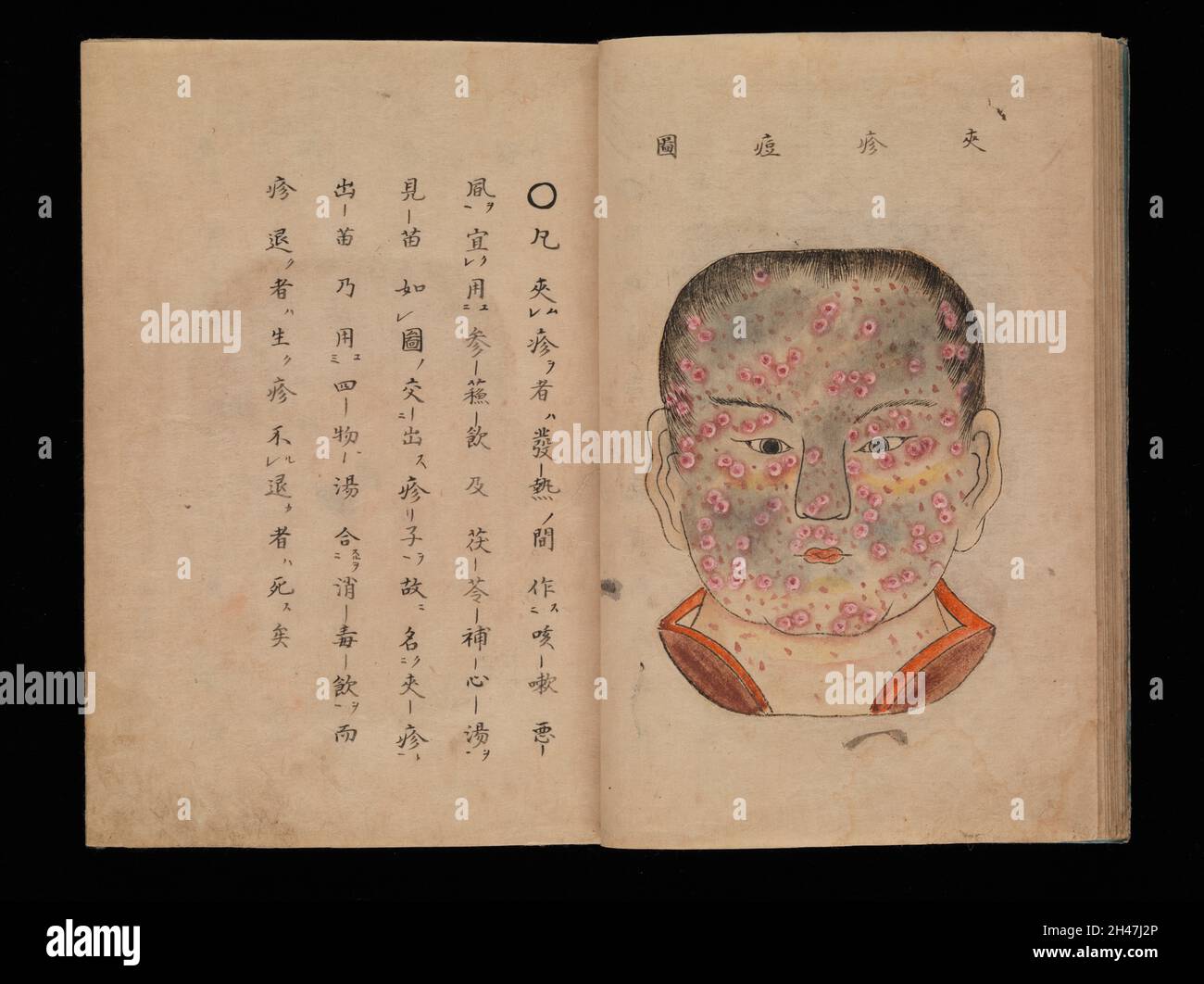 Smallpox illustration, Japanese manuscript, c. 1720 Stock Photo - Alamy