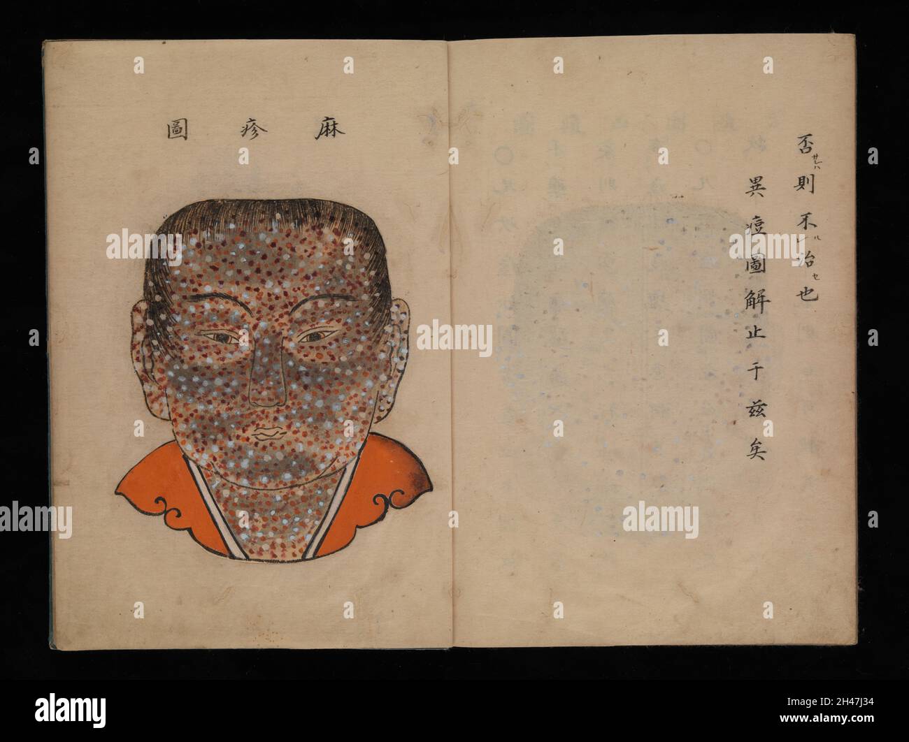 Smallpox illustration, Japanese manuscript, c. 1720 Stock Photo - Alamy