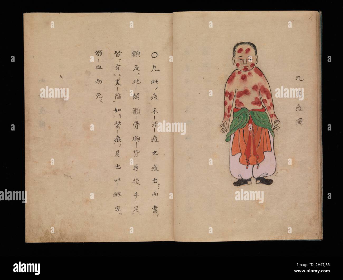 Smallpox illustration, Japanese manuscript, c. 1720 Stock Photo - Alamy