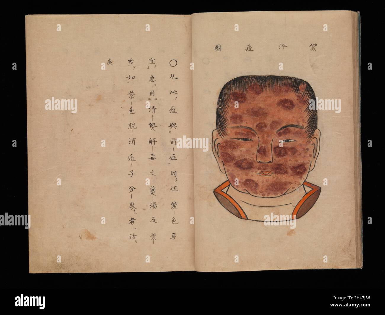 Smallpox illustration, Japanese manuscript, c. 1720 Stock Photo - Alamy