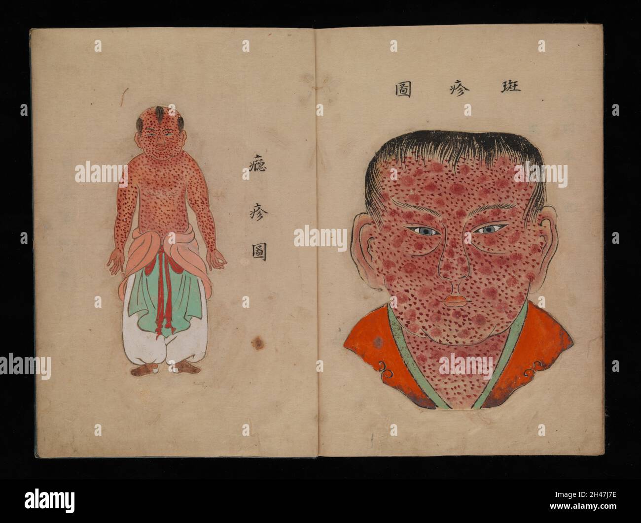 Smallpox illustration, Japanese manuscript, c. 1720 Stock Photo - Alamy