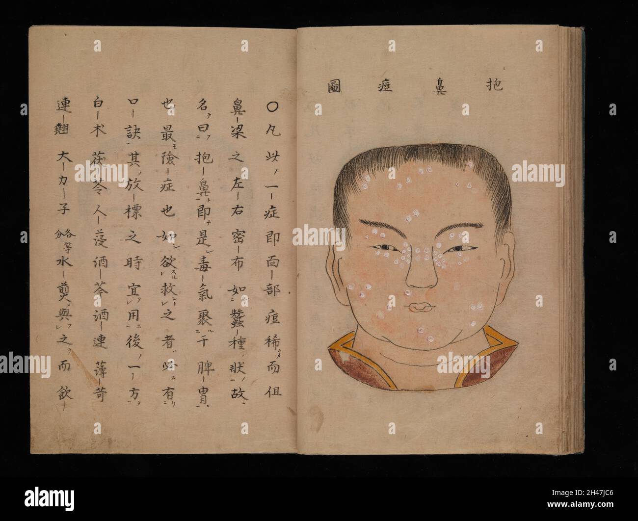 Smallpox illustration, Japanese manuscript, c. 1720 Stock Photo - Alamy