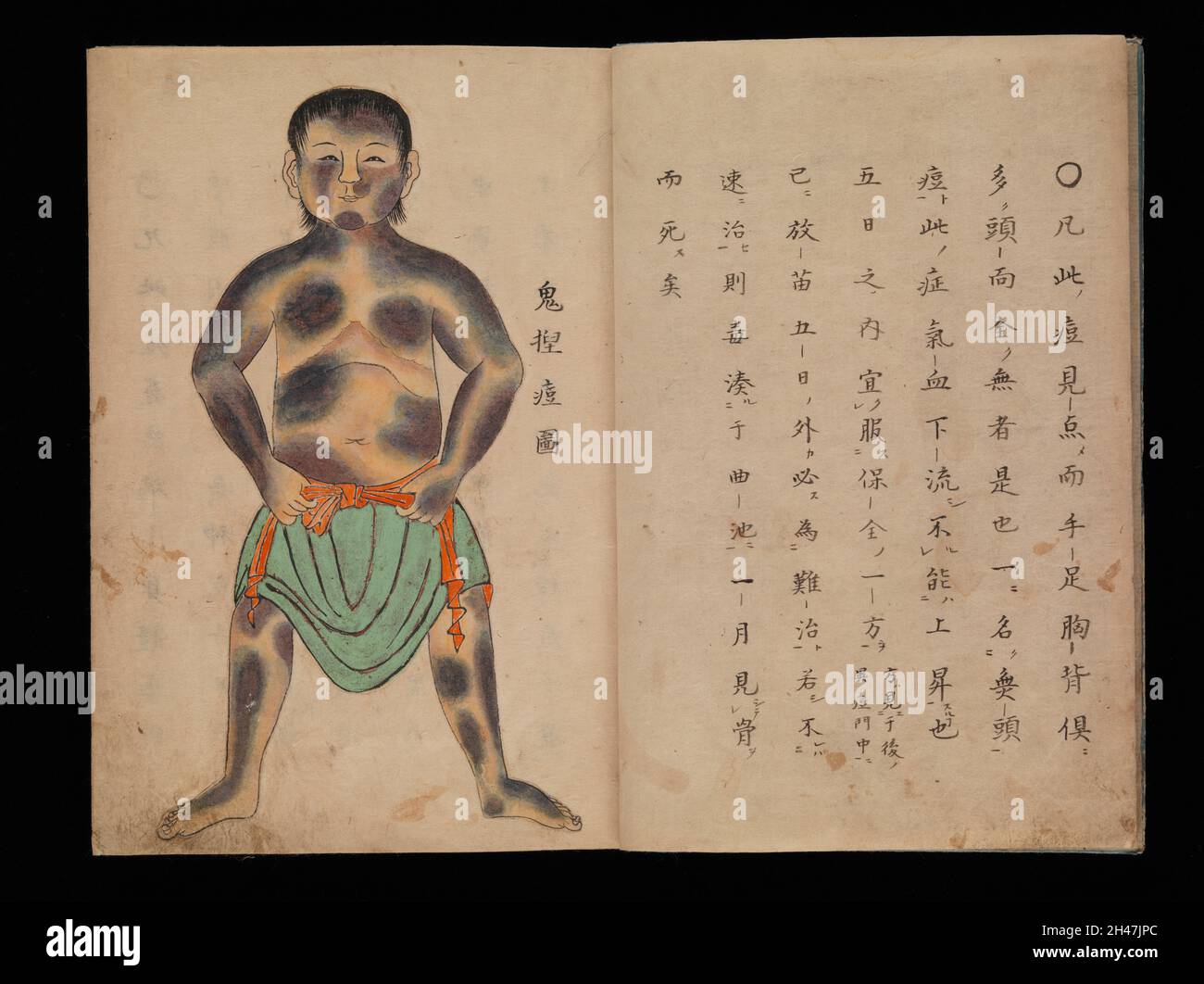 Smallpox illustration, Japanese manuscript, c. 1720 Stock Photo - Alamy