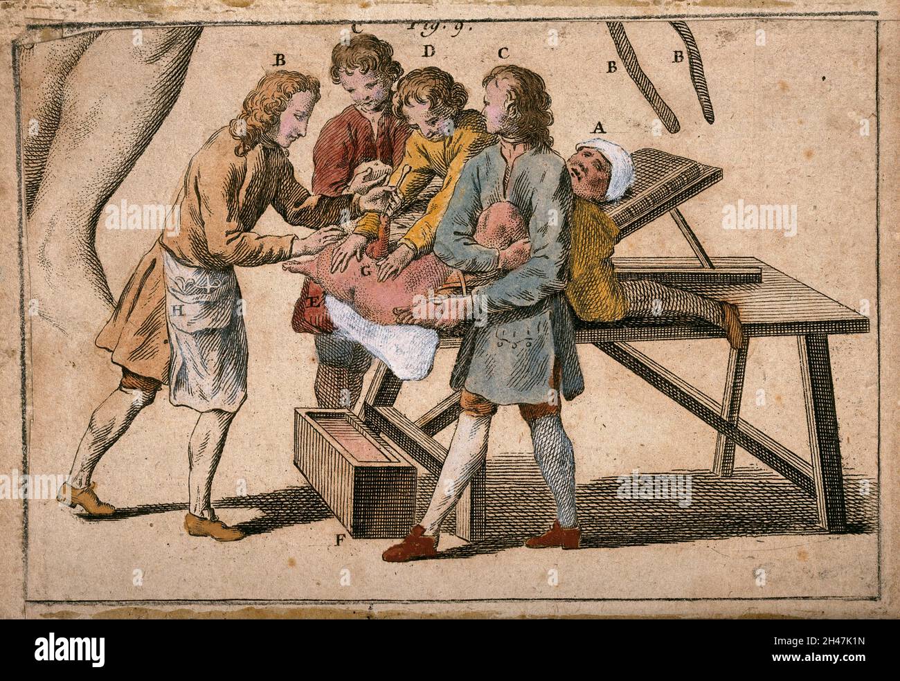 A surgeon performing a lithotomy on a patient who is being restrained ...