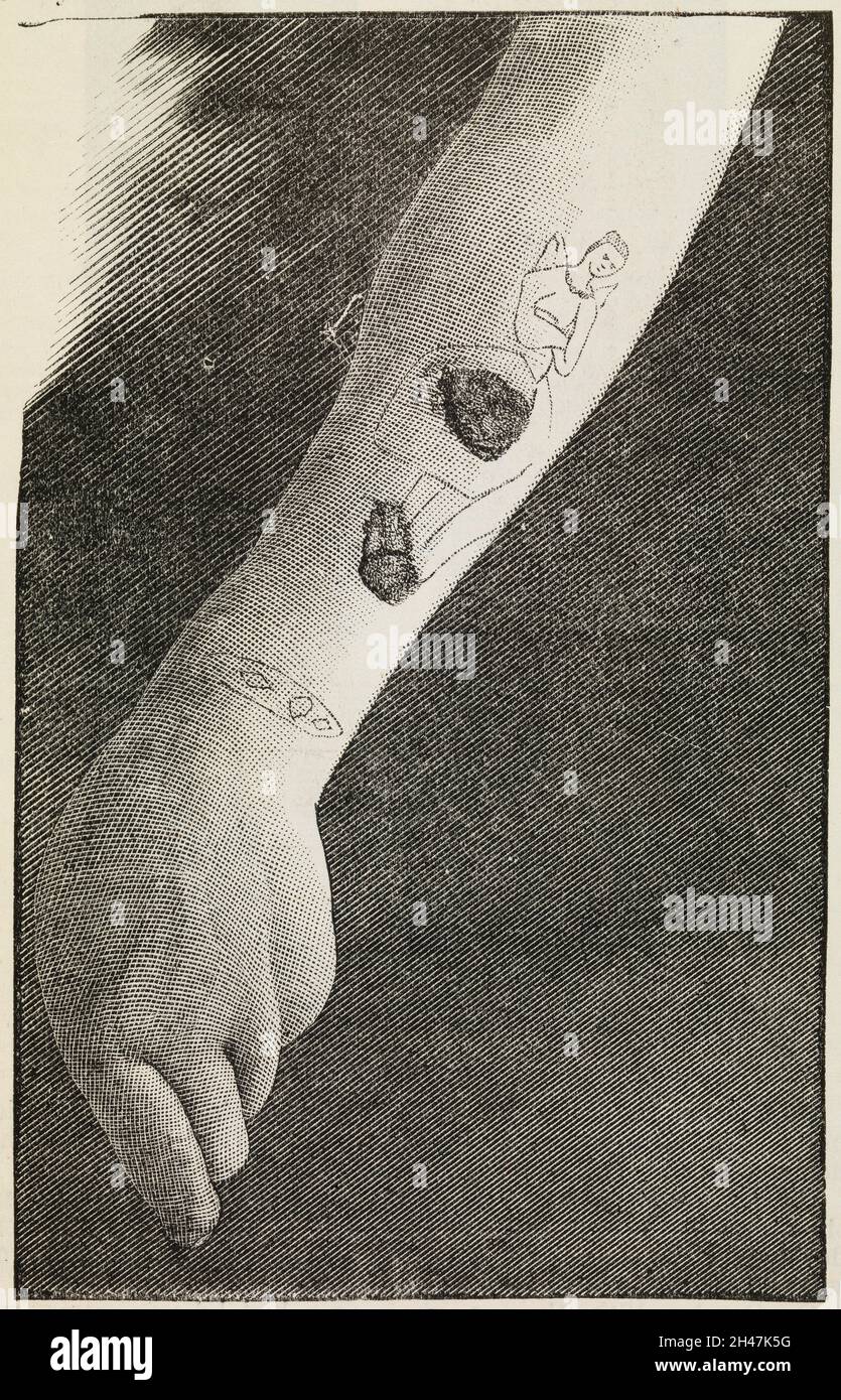 Signs of syphilis on the site of a tattoo Stock Photo - Alamy