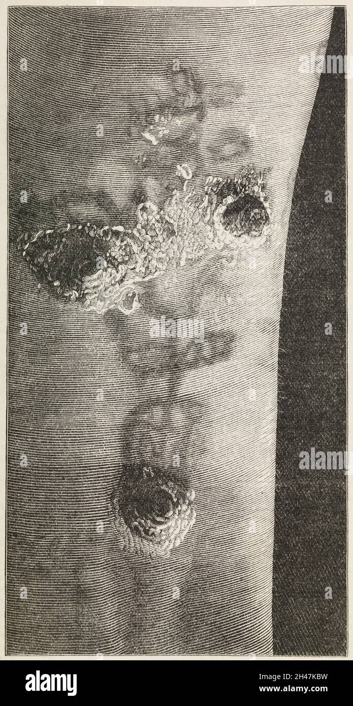 Signs of syphilis on the site of a tattoo Stock Photo - Alamy