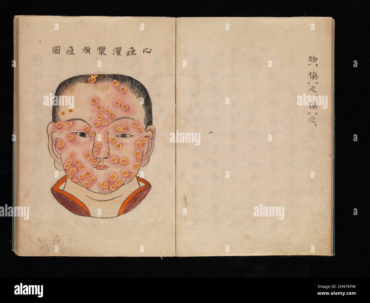 Medicine diseases historical smallpox hi-res stock photography and ...