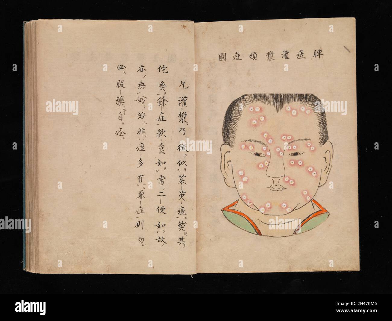 Smallpox illustration, Japanese manuscript, c. 1720 Stock Photo - Alamy