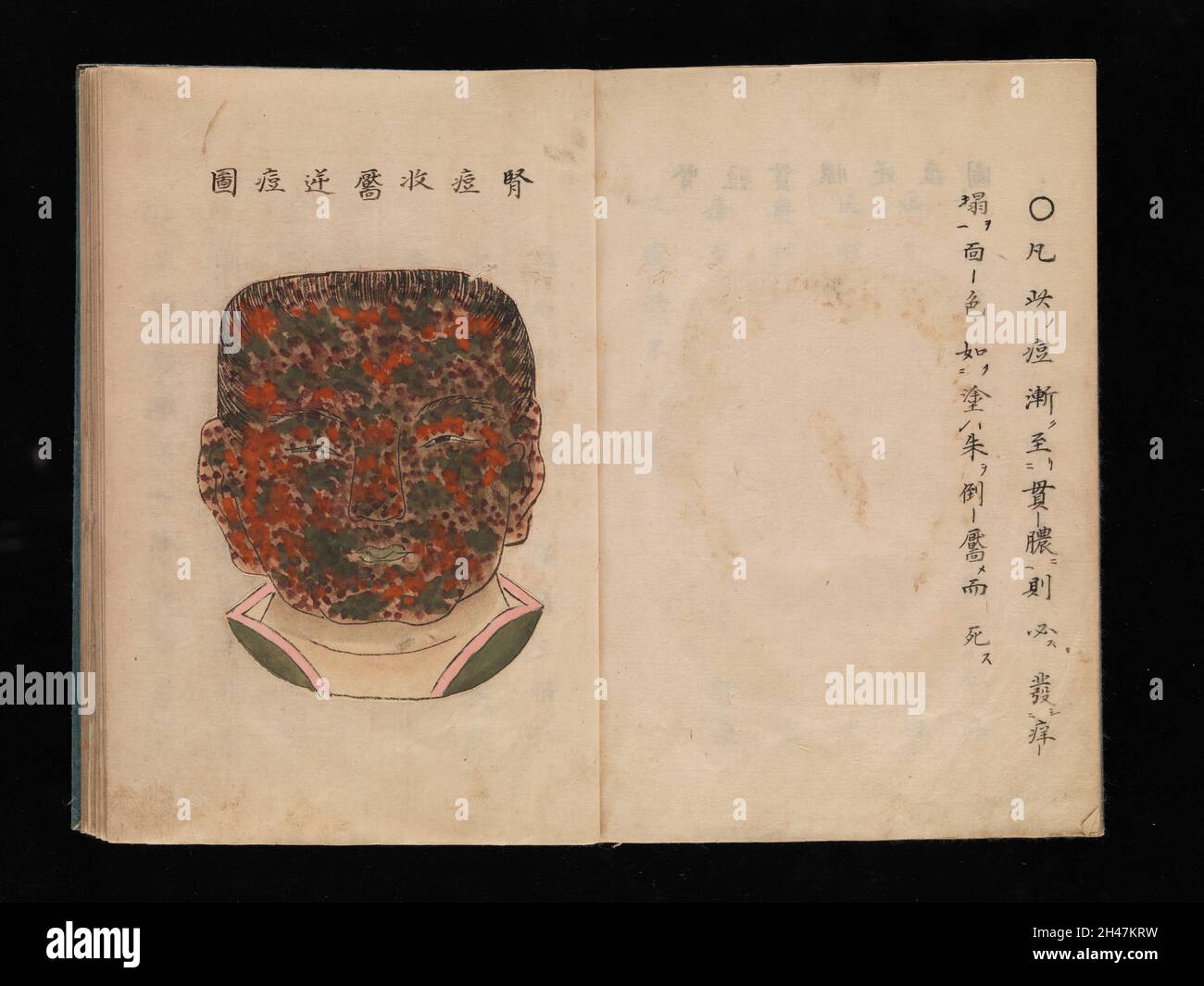 Smallpox illustration, Japanese manuscript, c. 1720 Stock Photo - Alamy