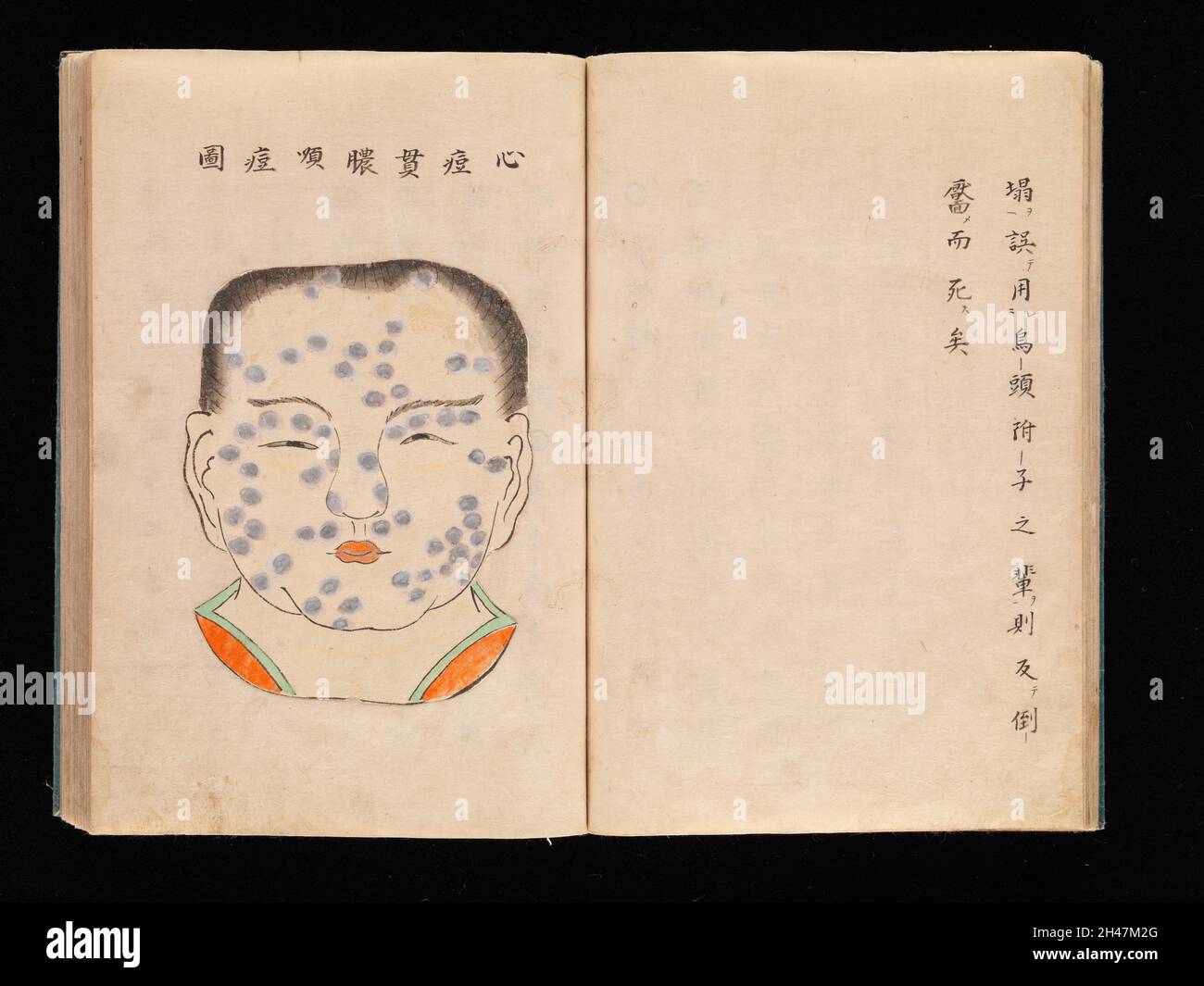 Smallpox illustration, Japanese manuscript, c. 1720 Stock Photo - Alamy