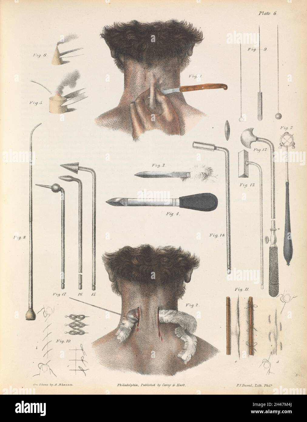 Plate VI. Various instruments and techniques used in surgery ...