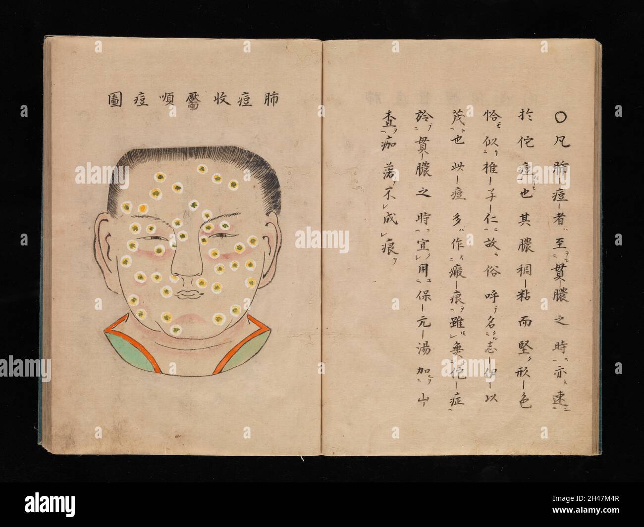 Smallpox illustration, Japanese manuscript, c. 1720 Stock Photo - Alamy