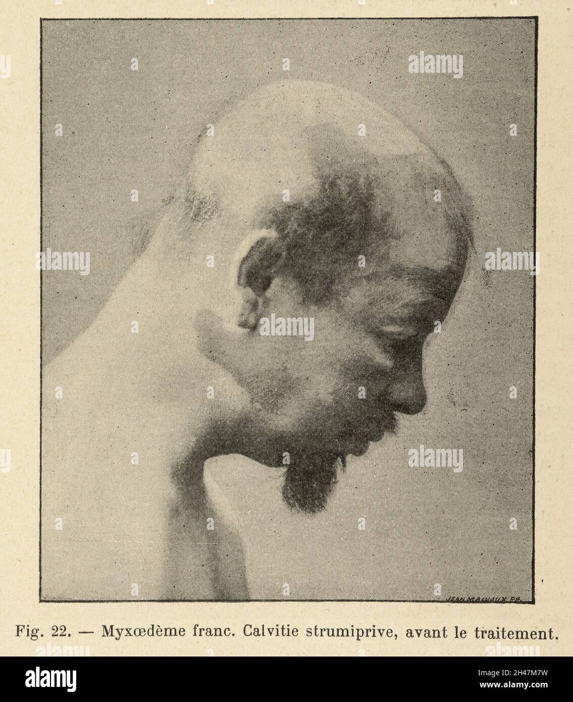 Male figure with myxedema, after treatment. Caption: 'Myxoedeme franc ...