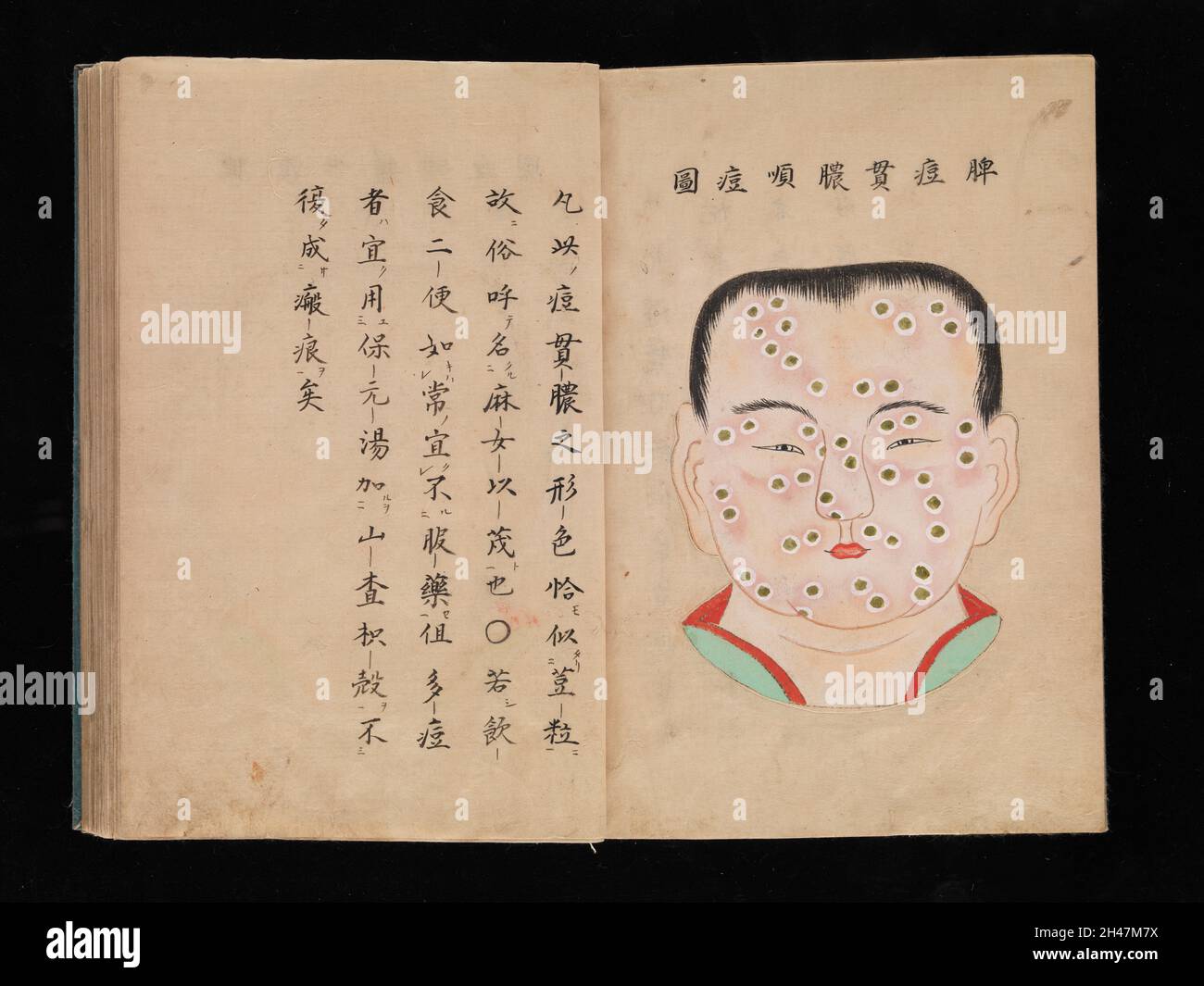 Smallpox illustration, Japanese manuscript, c. 1720 Stock Photo - Alamy