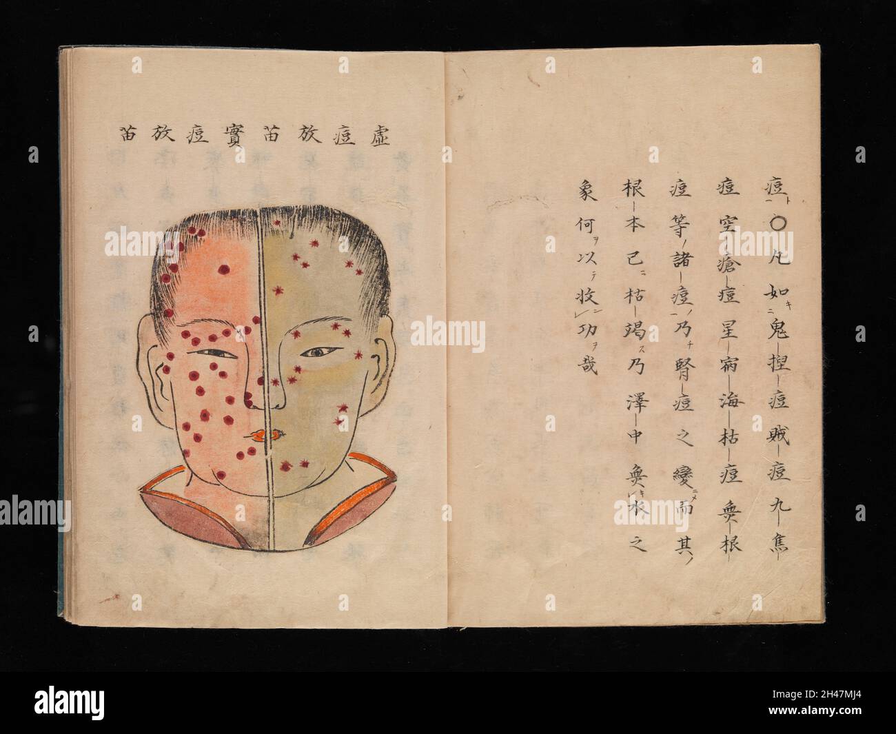 Smallpox illustration, Japanese manuscript, c. 1720 Stock Photo - Alamy