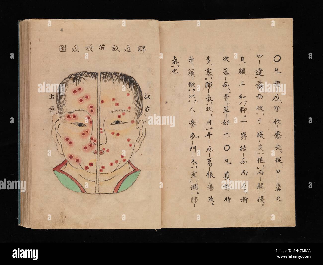 Smallpox illustration, Japanese manuscript, c. 1720 Stock Photo - Alamy