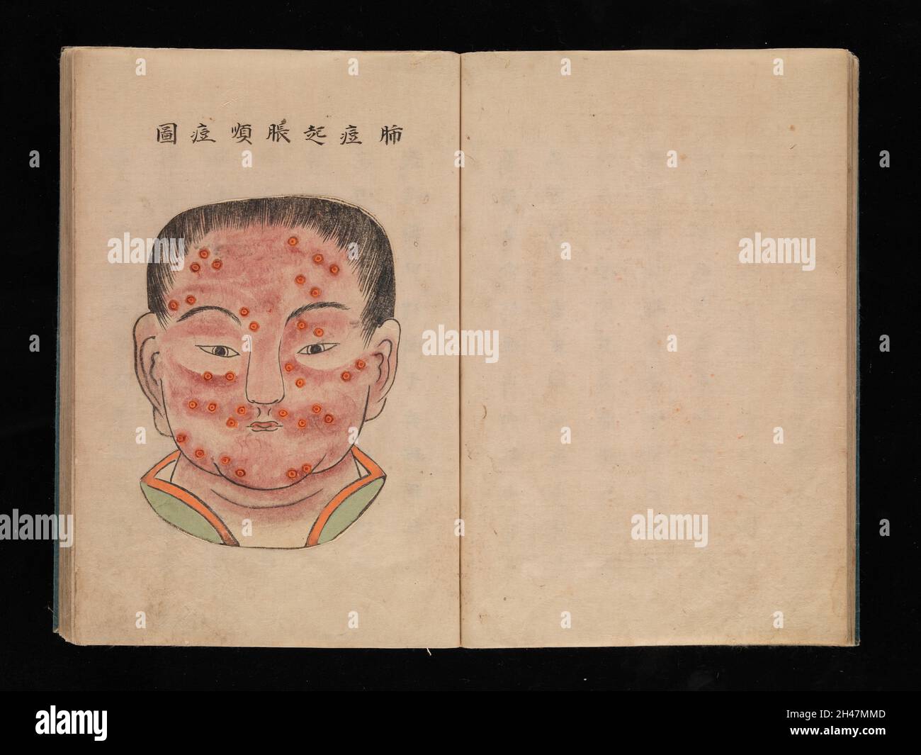 Smallpox illustration, Japanese manuscript, c. 1720 Stock Photo - Alamy