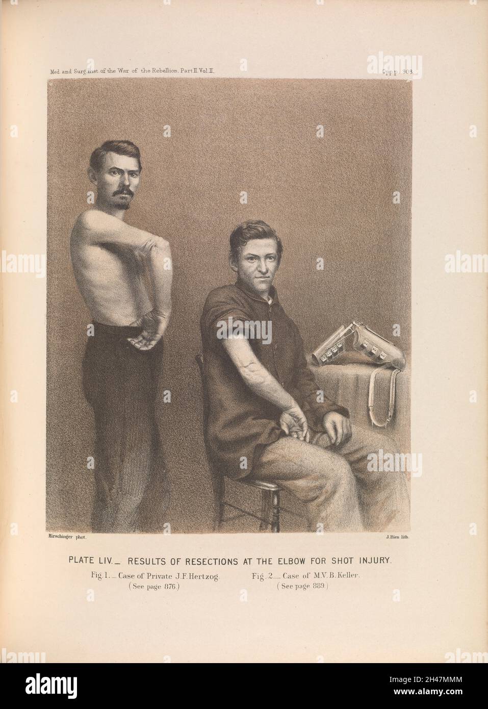 Plate LIV. Results of resections at the elbow for shot injury. American ...