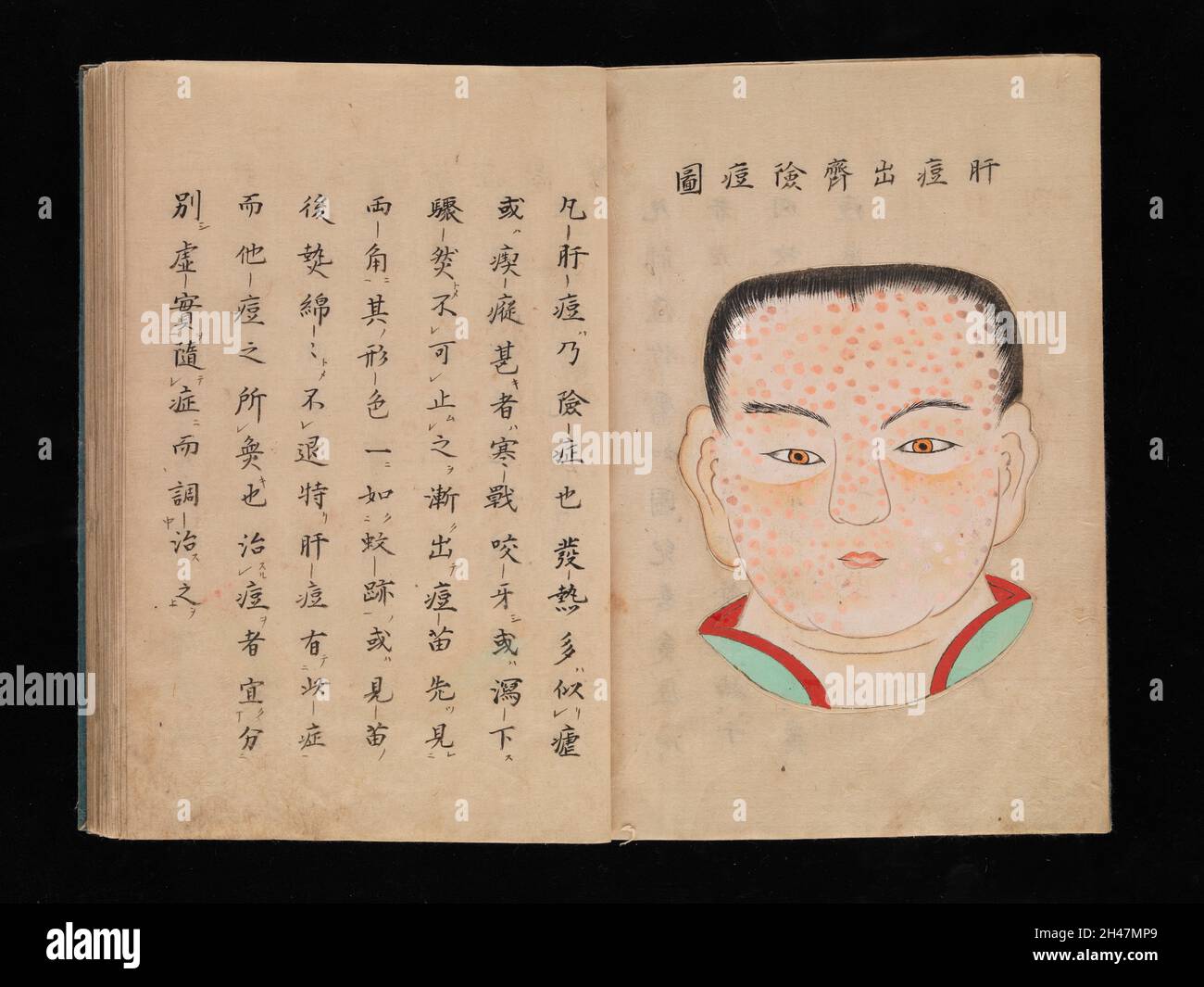 Smallpox illustration, Japanese manuscript, c. 1720 Stock Photo - Alamy