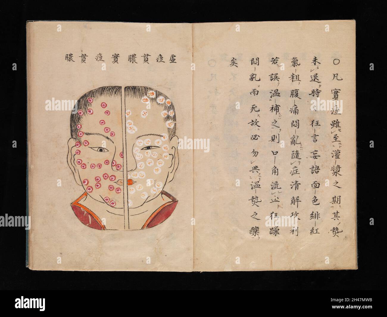 Smallpox illustration, Japanese manuscript, c. 1720 Stock Photo - Alamy